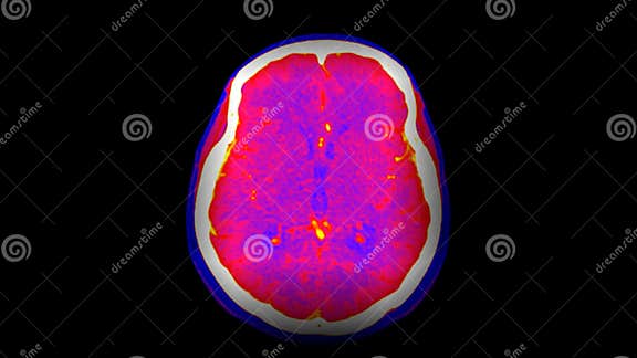 CT Brain Perfusion or CT Scan Image of the Brain Axial View Stock Image ...