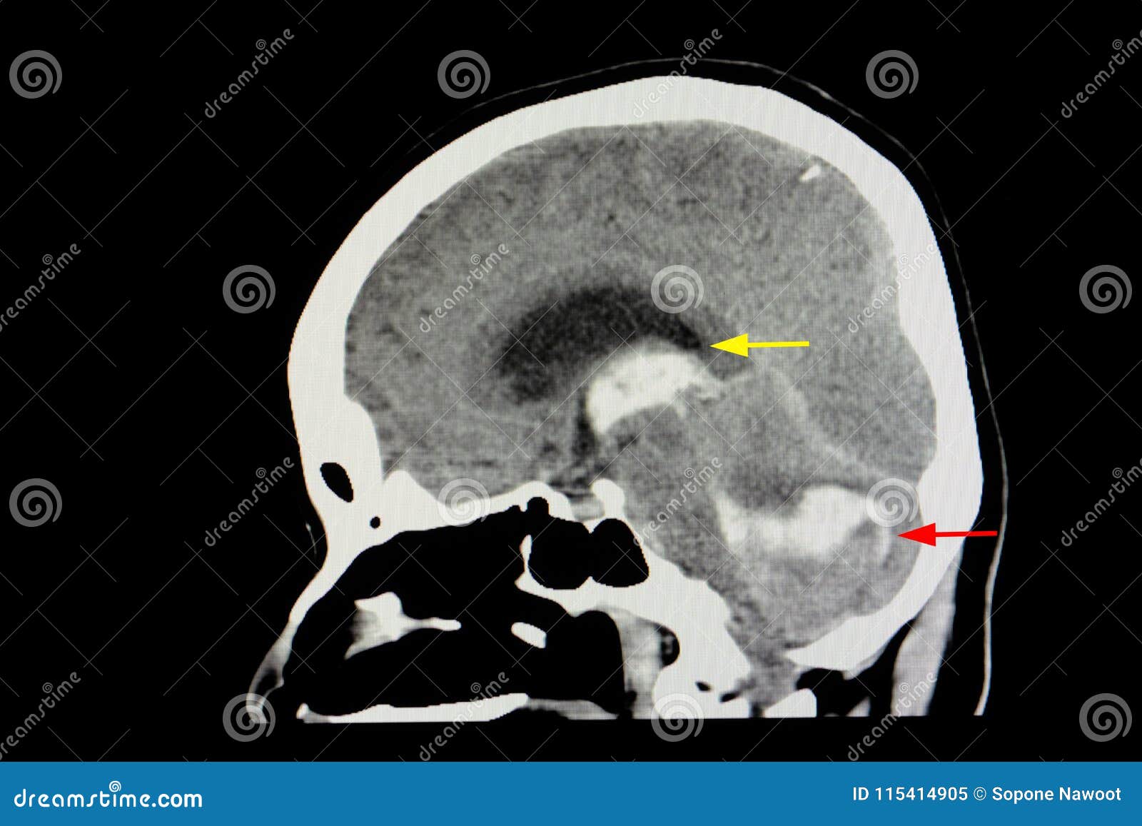 CT Brain Scan Del Paciente Del Movimiento Imagen de archivo - Imagen de ...