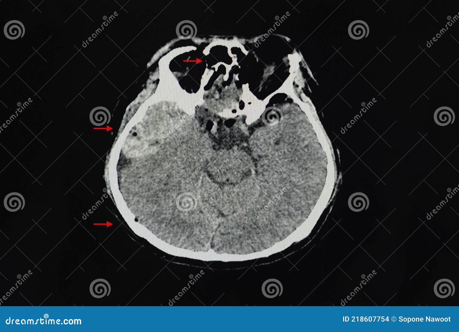 Epidural Hematoma At Right Parietal Loab And Subdural Hematoma At Left Frontal Lobe With Mass