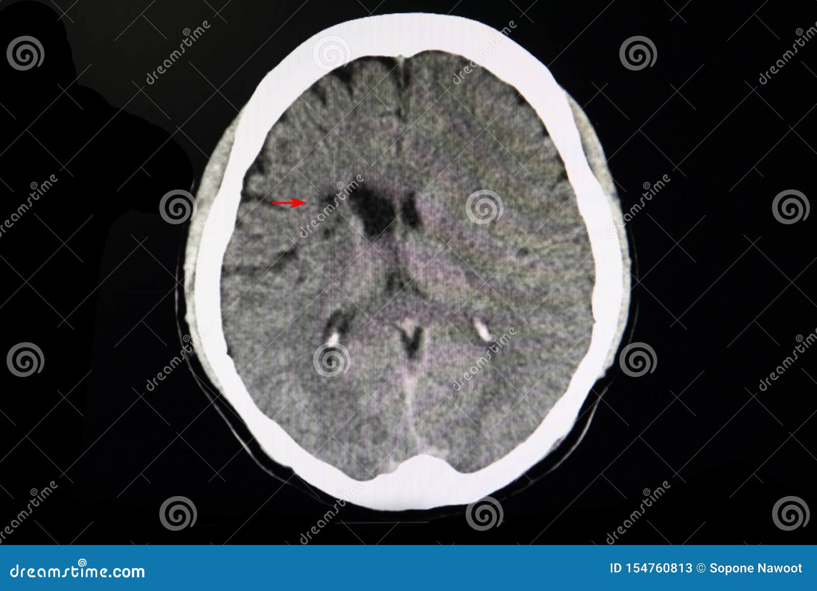 Stroke Patient At Occupational Therapy In Rehab Center Stock Photo ...