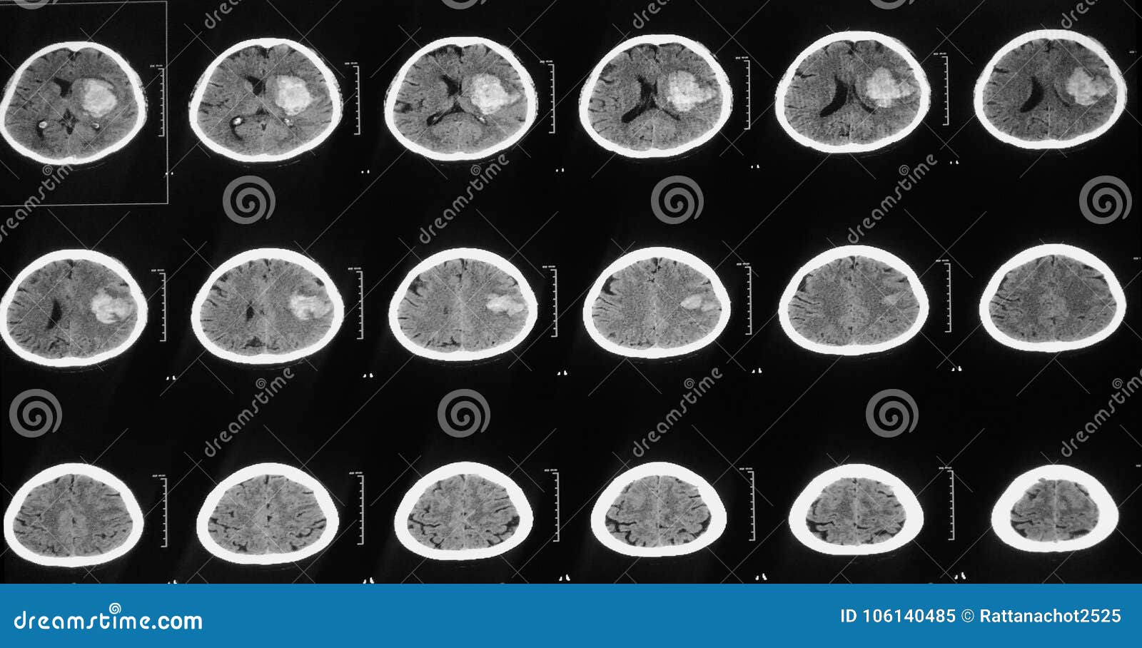 CT-Brain stock image. Image of illness, neurosurgery - 106140485
