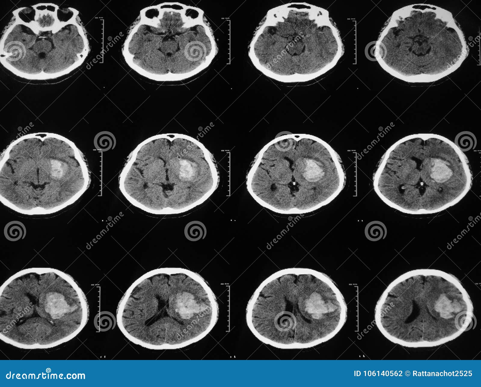 CT-Brain stock photo. Image of illness, scan, healthcare - 106140562