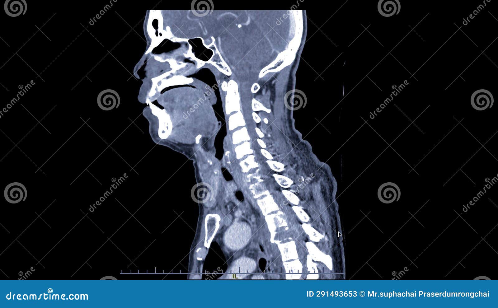 CT C-Spine or Cervical Spine Sagittal View Stock Image - Image of ...