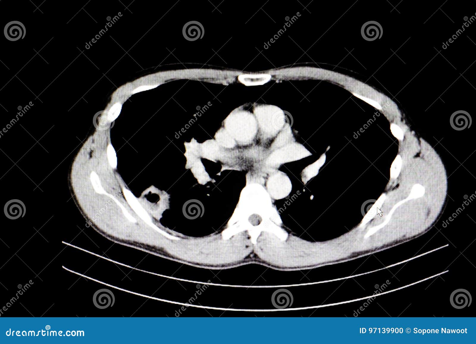 CT chest stock photo. Image of chest, patient, white - 97139900