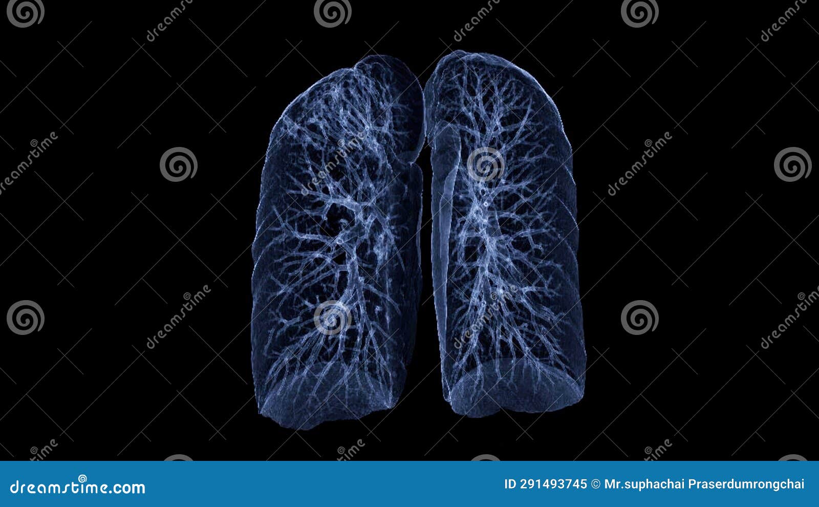 CT Chest or CT Lung 3d Rendering Image with Blue Color Showing Trachea ...