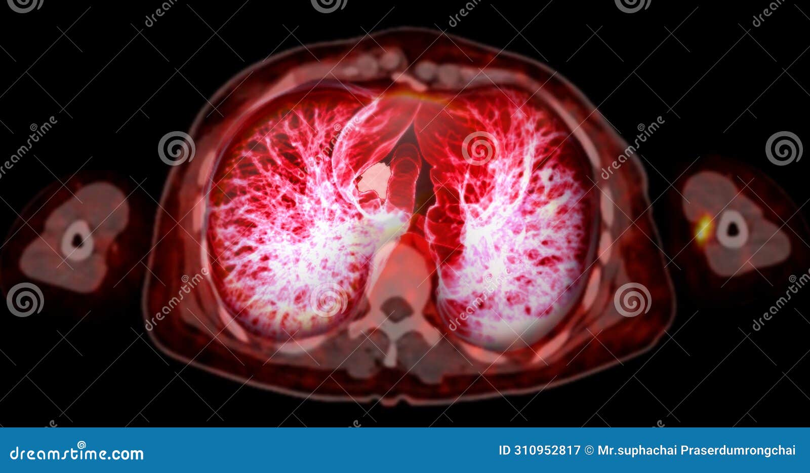 CT Chest or Lung 3d Rendering Image Showing Trachea and Lung in ...