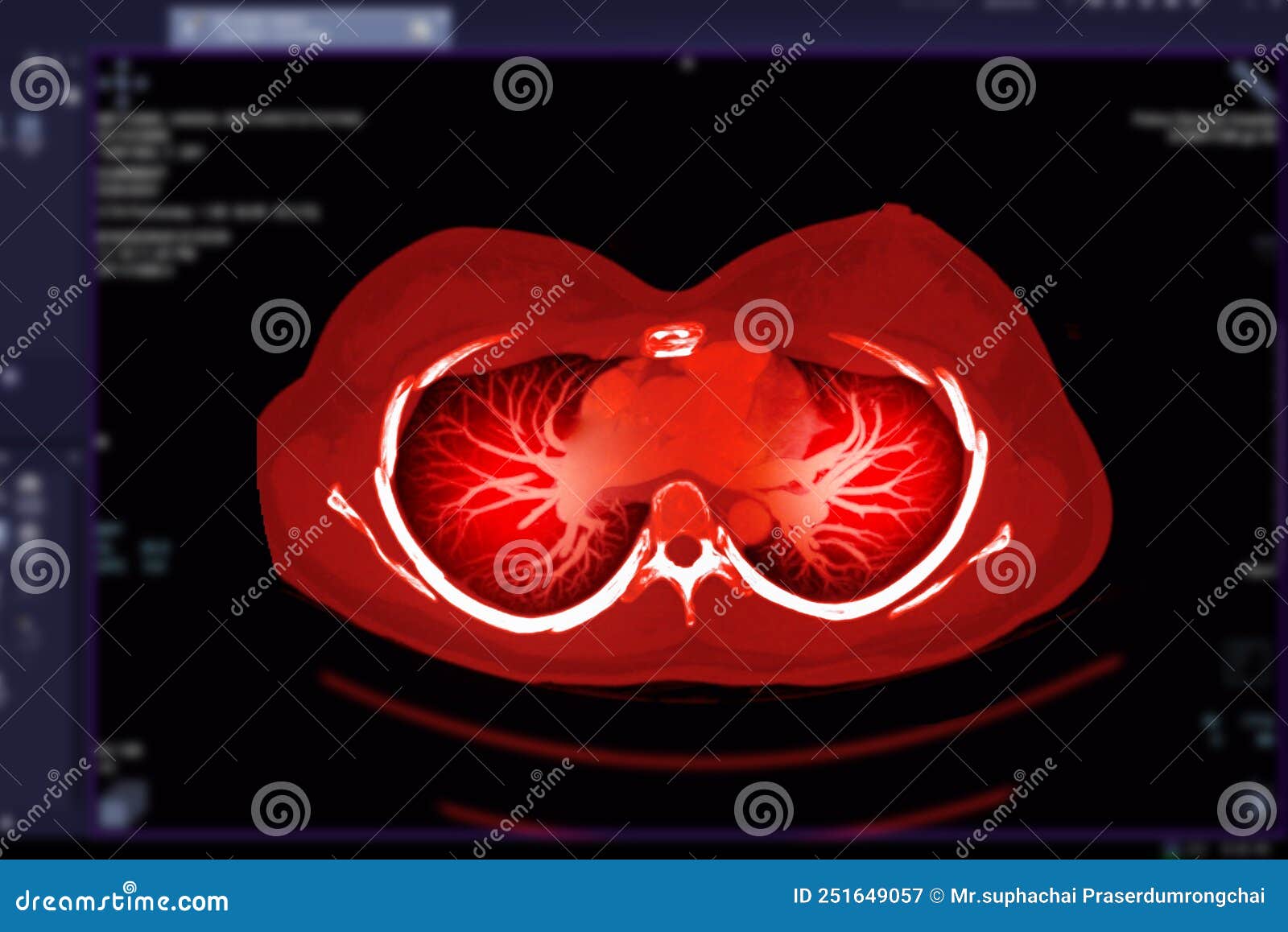 CT Chest or CT Scan of Lung Axial and Coronal View Stock Image - Image ...