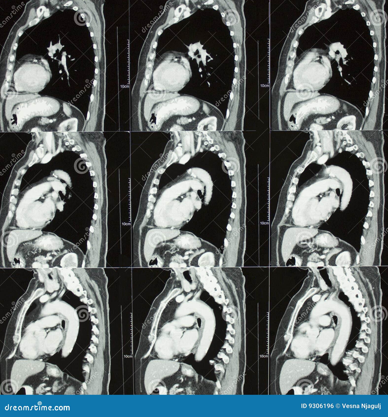 CT of Chest and Spine stock photo. Image of computed, axial - 9306196