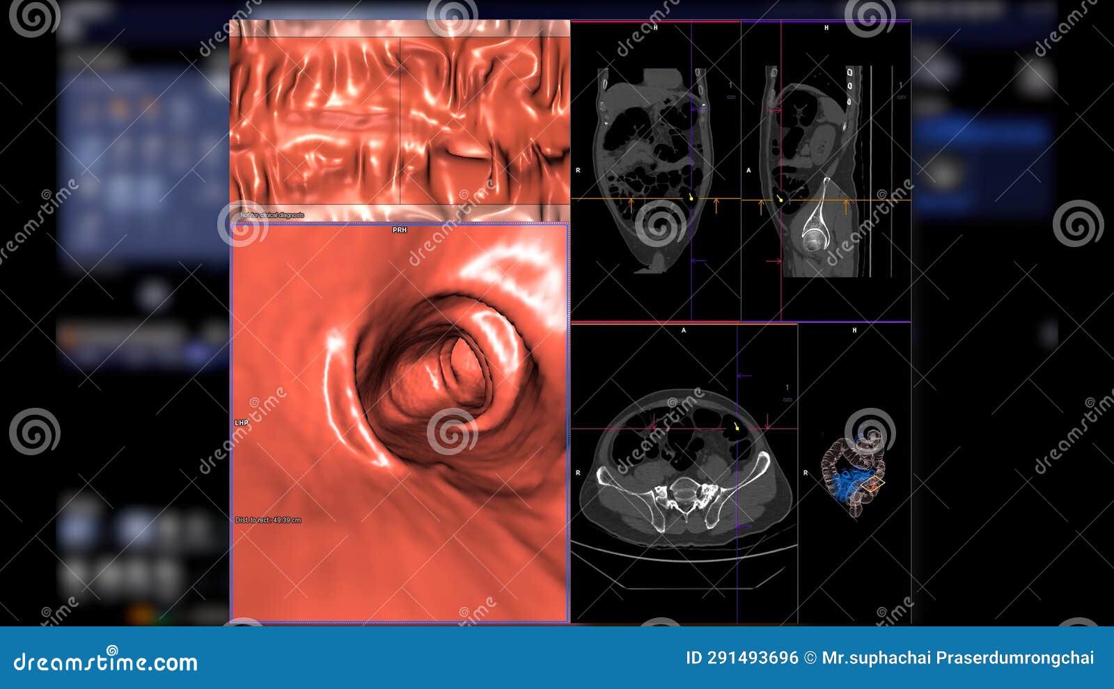 CT Colonography Compare 2D Axial,sagittal ,coronal Plane And 3D ... CT Colonography Compare 2D Axial,sagittal ,coronal Plane And 3D ...