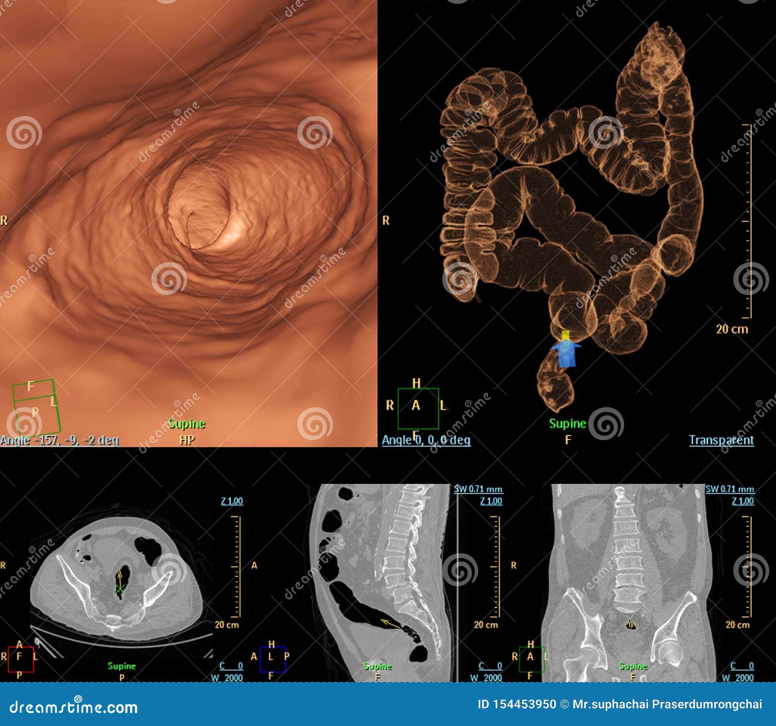 CT Colonography 3D And 2D Axial,sagittal ,coronal Plane . Stock ... CT Colonography 3D And 2D Axial,sagittal ,coronal Plane . Stock ...