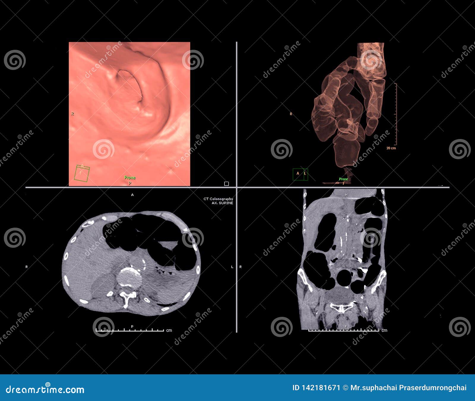 CT Colonography or CT Scan of Colon. Stock Image - Image of medicine ... CT Colonography or CT Scan of Colon. Stock Image - Image of medicine ...