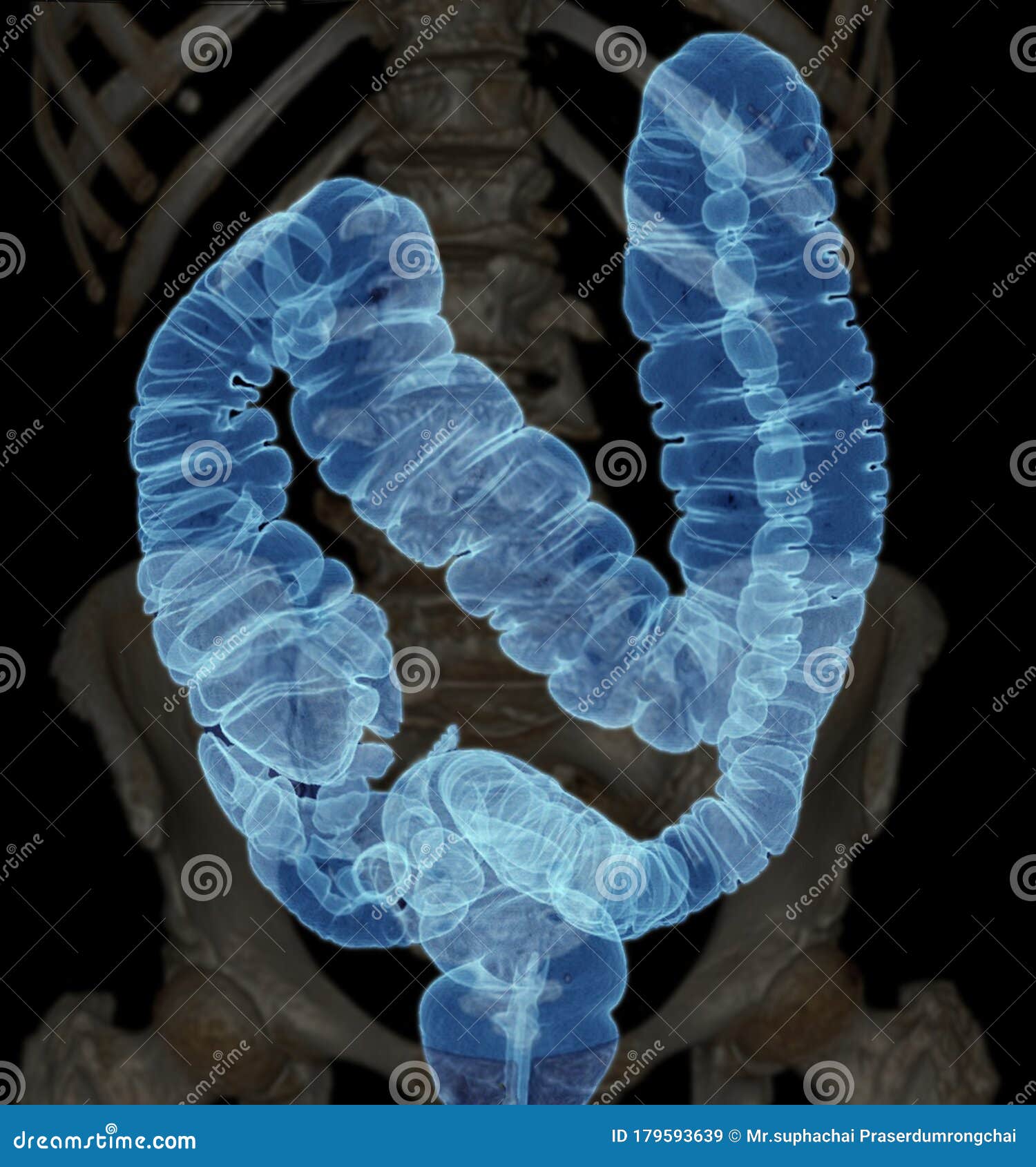 CT Colonography or CT Scan of Colon 3D Rendering Image AP View Showing ... CT Colonography or CT Scan of Colon 3D Rendering Image AP View Showing ...