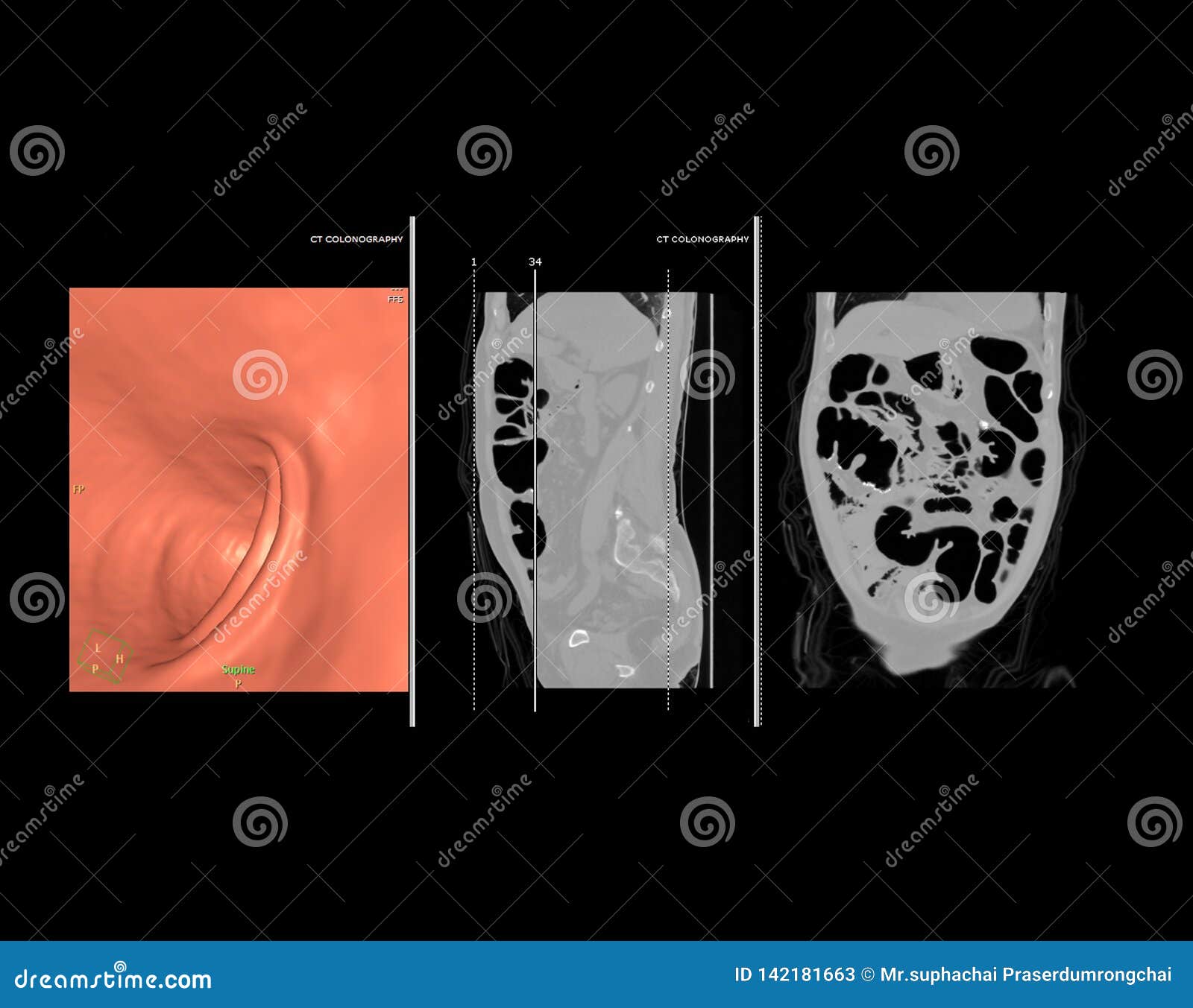 CT Colonography or CT Scan of Colon 3D Rendering Image. Stock Image ... CT Colonography or CT Scan of Colon 3D Rendering Image. Stock Image ...