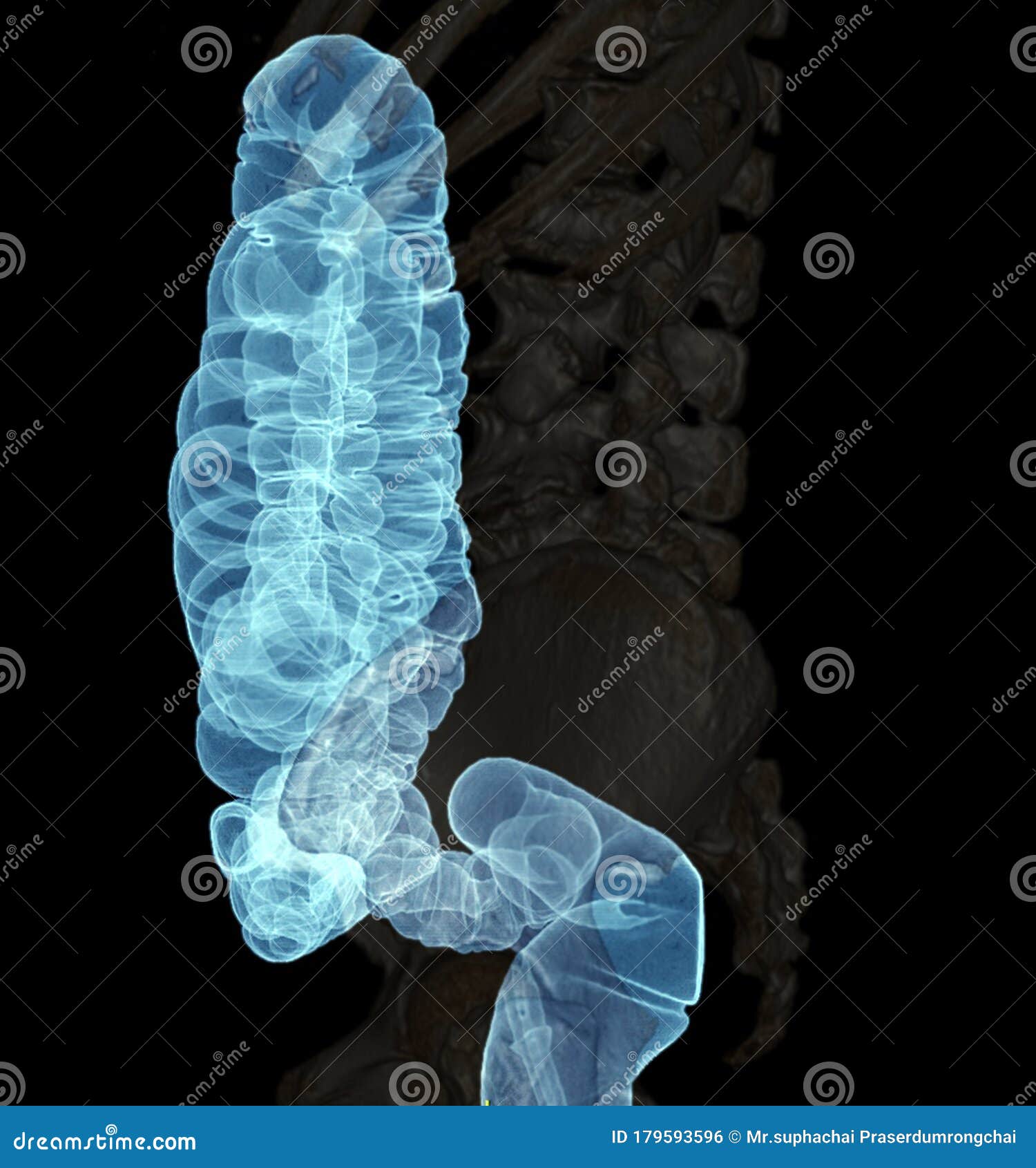 CT Colonography or CT Scan of Colon 3D Rendering Image Lateral View ... CT Colonography or CT Scan of Colon 3D Rendering Image Lateral View ...