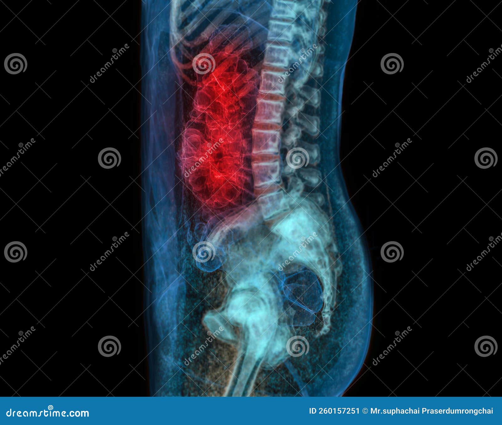 CT Colonography Or CT Scan Of Colon 3D Rendering Image For Screening ... CT Colonography Or CT Scan Of Colon 3D Rendering Image For Screening ...