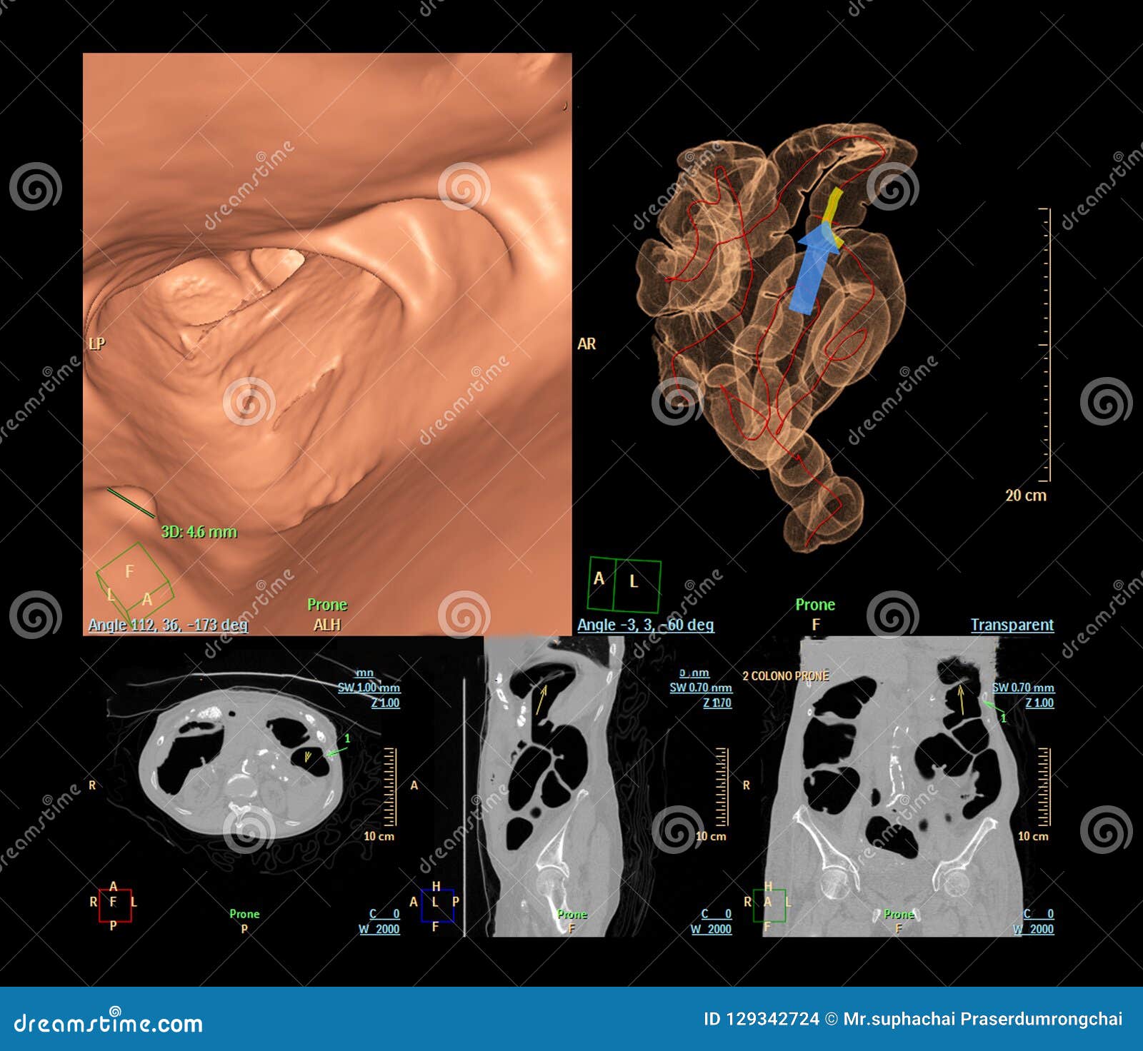CT Colonography is Highly Sensitive for Colorectal Cancer, 3D Rendering ...