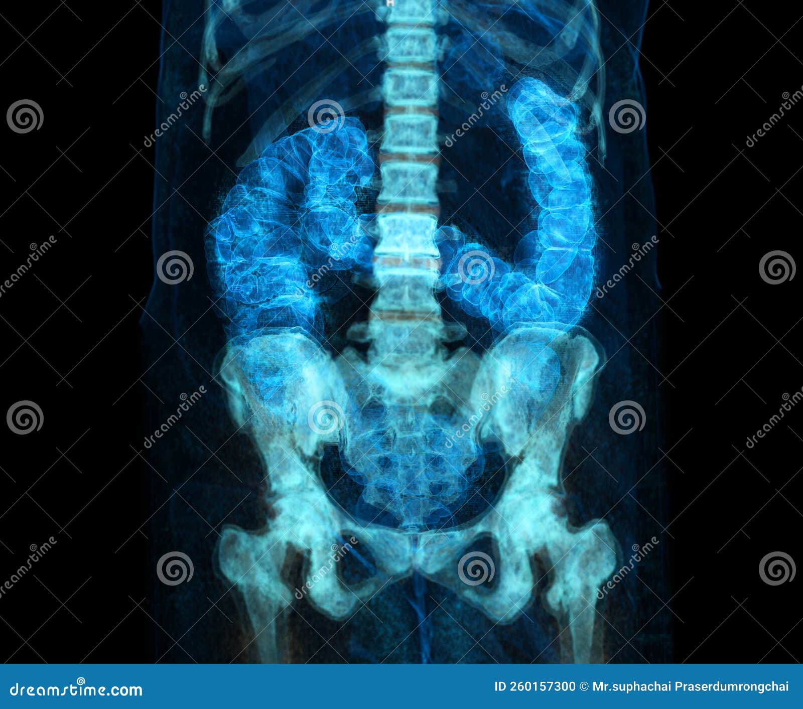 CT Colonography Or CT Scan Of Colon 3D Rendering Image For Screening ... CT Colonography Or CT Scan Of Colon 3D Rendering Image For Screening ...