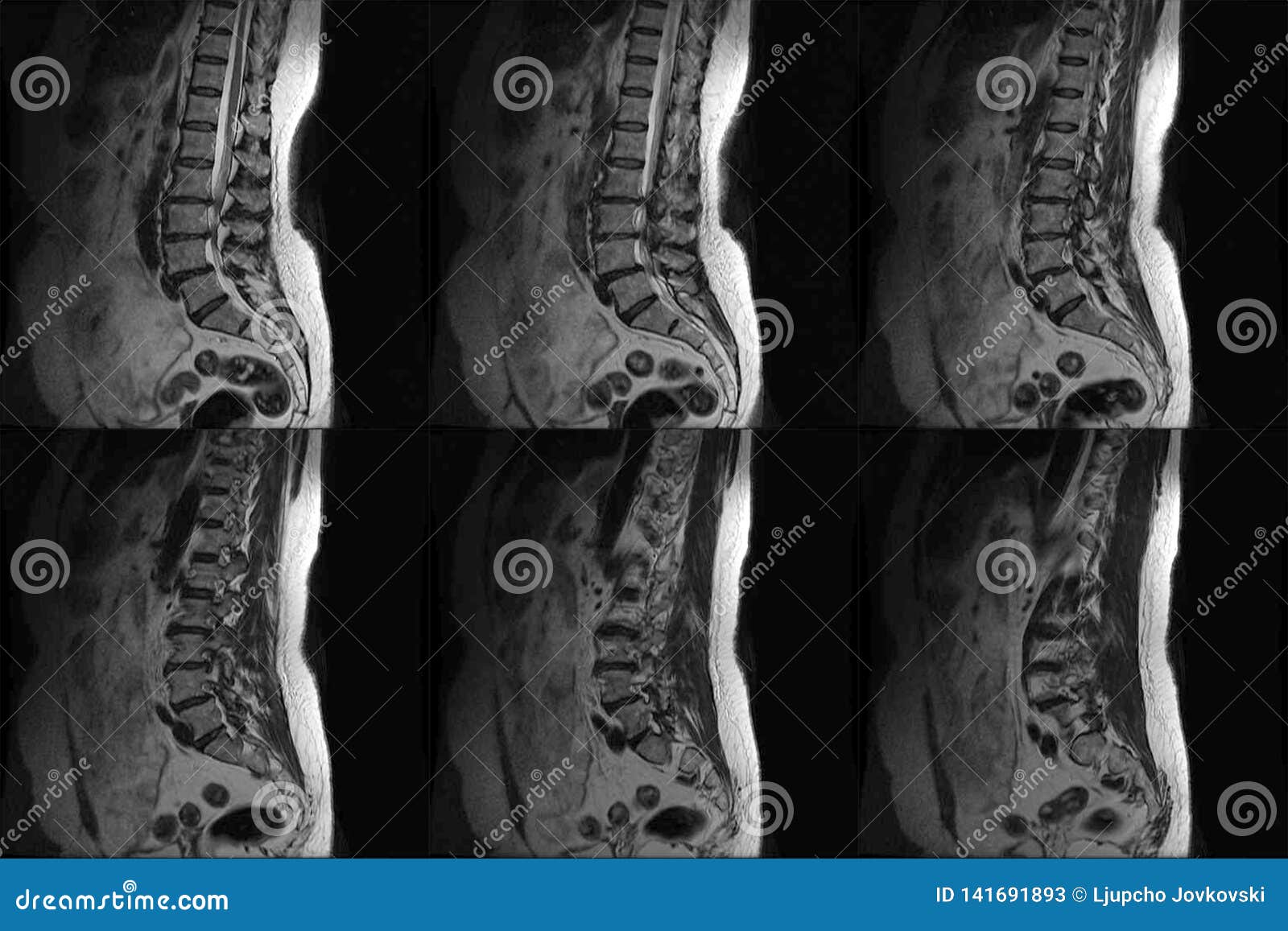 Magnetic Resonance Imaging Mri Scan Showing Spinal Co Open I Hot Sex
