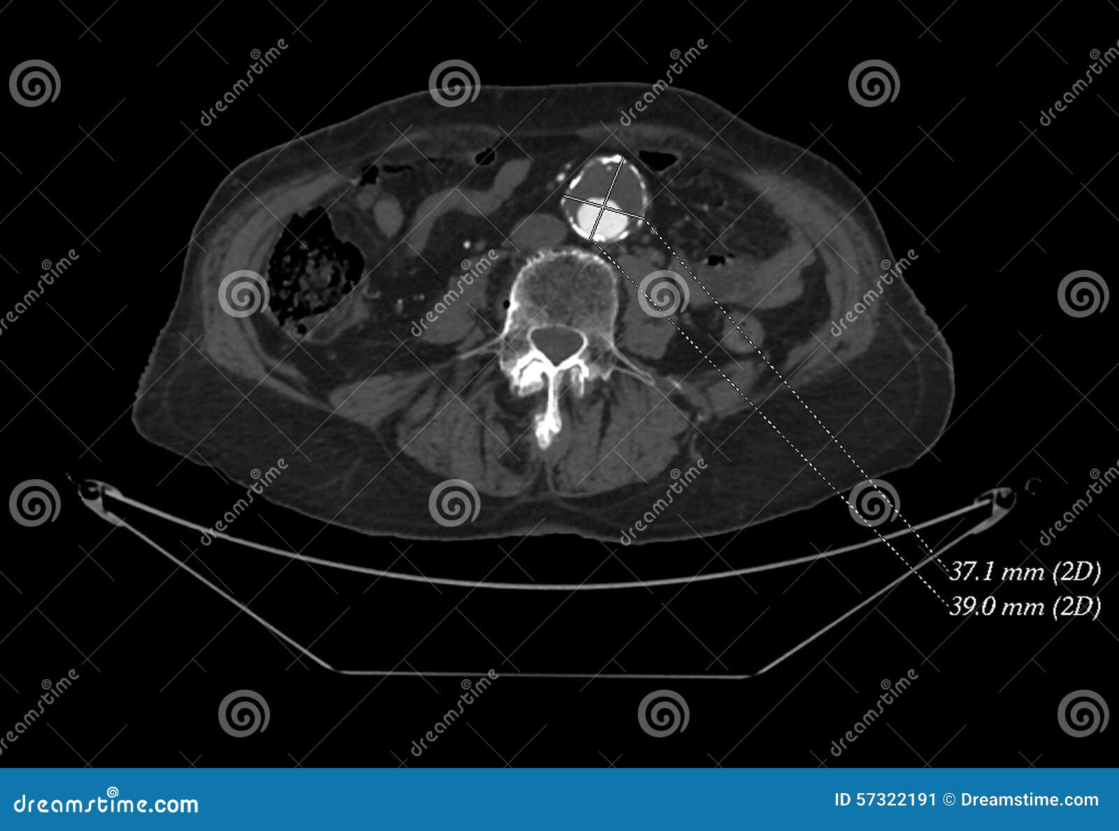 CT of Contrasted Aorta Dissection Measured Stock Image - Image of ...