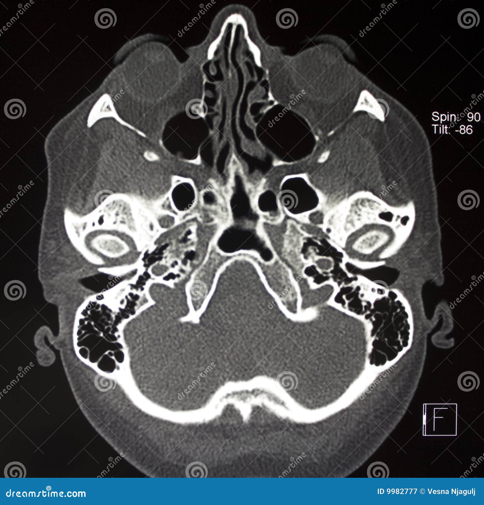 CT de huesos craneales imagen de archivo. Imagen de rayo - 9982777