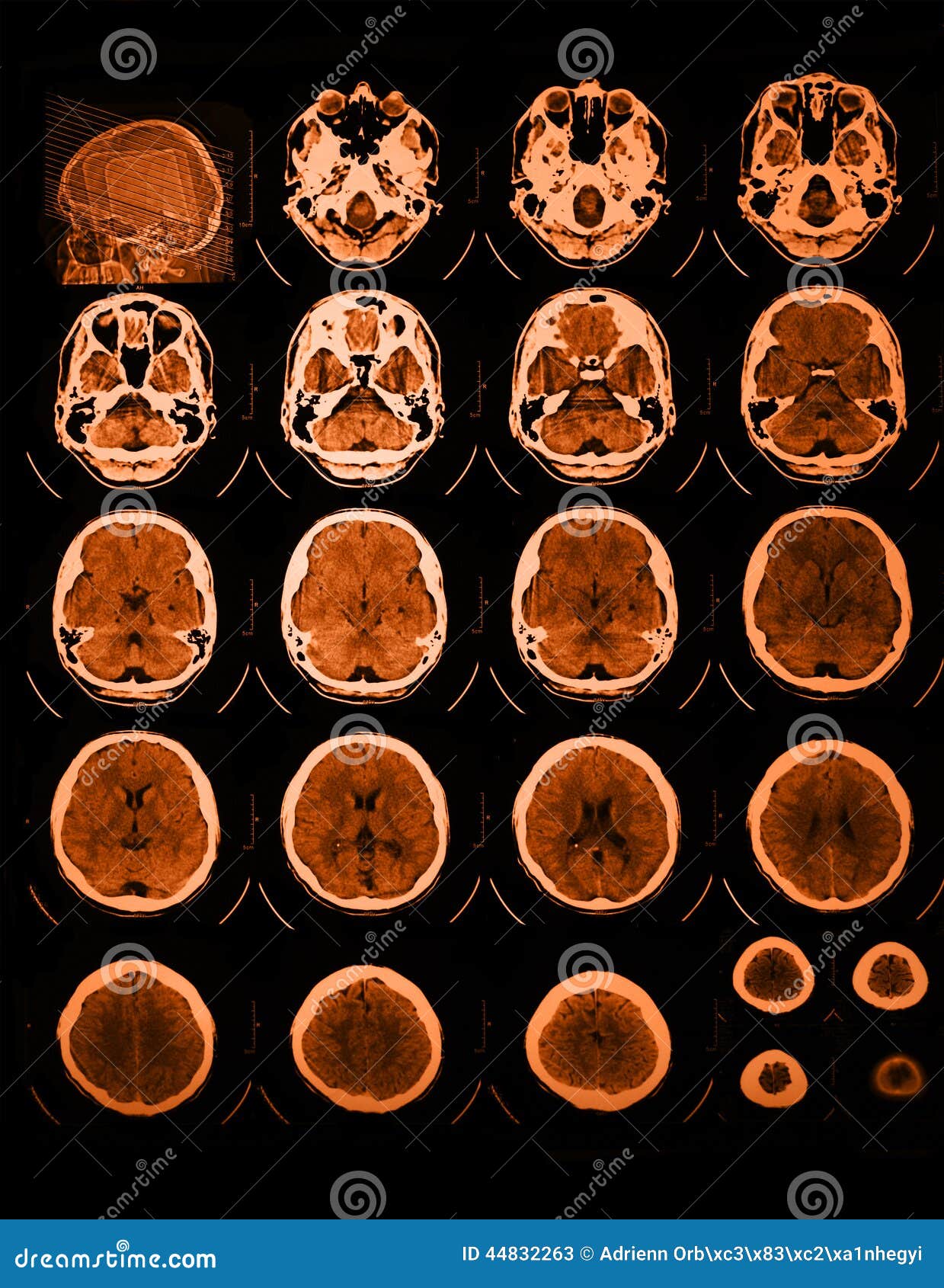 CT en MRI van de schedel stock afbeelding. Image of beeld - 44832263
