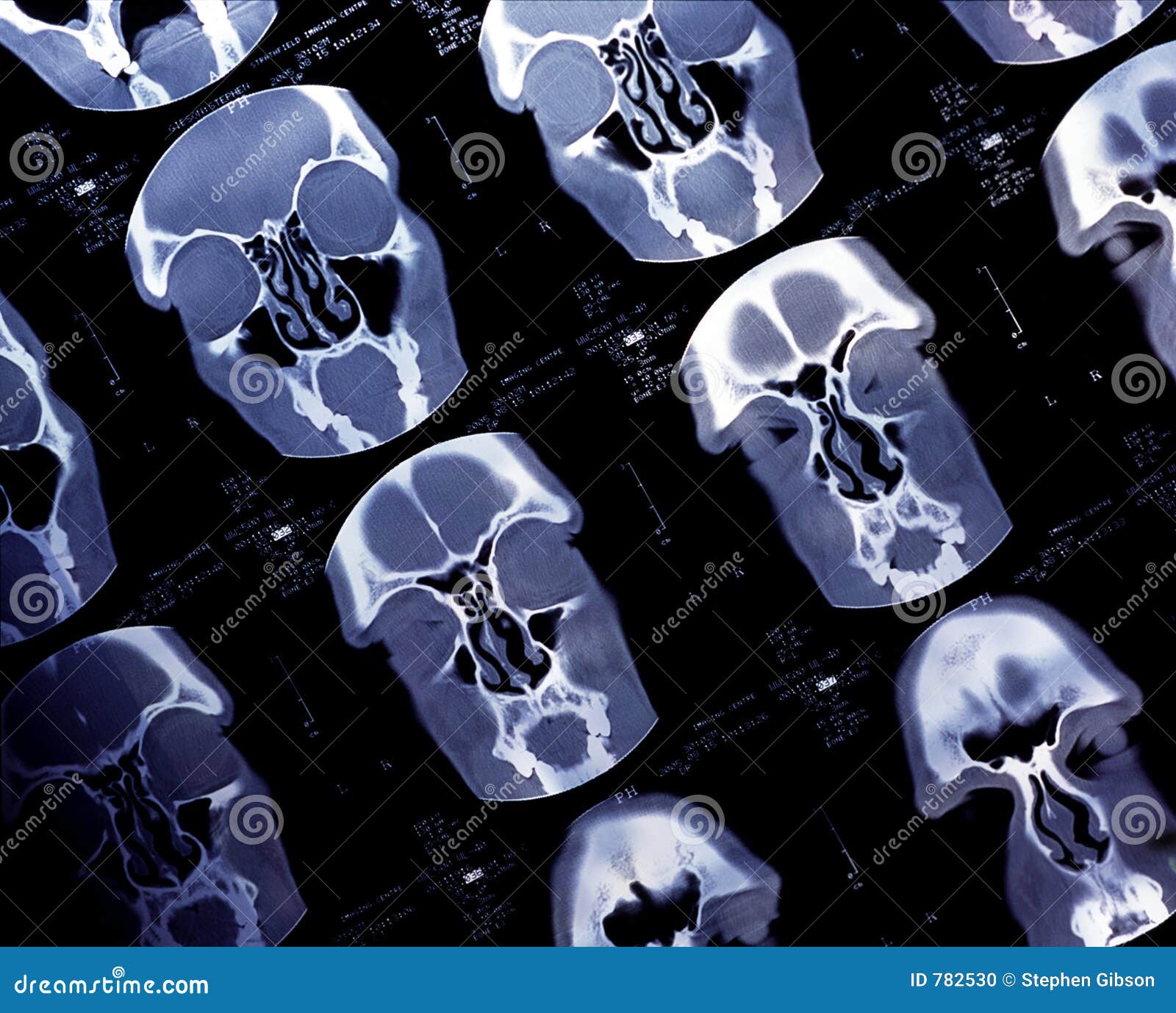 CT Head Scan stock photo. Image of xray, diagnose, scan - 782530