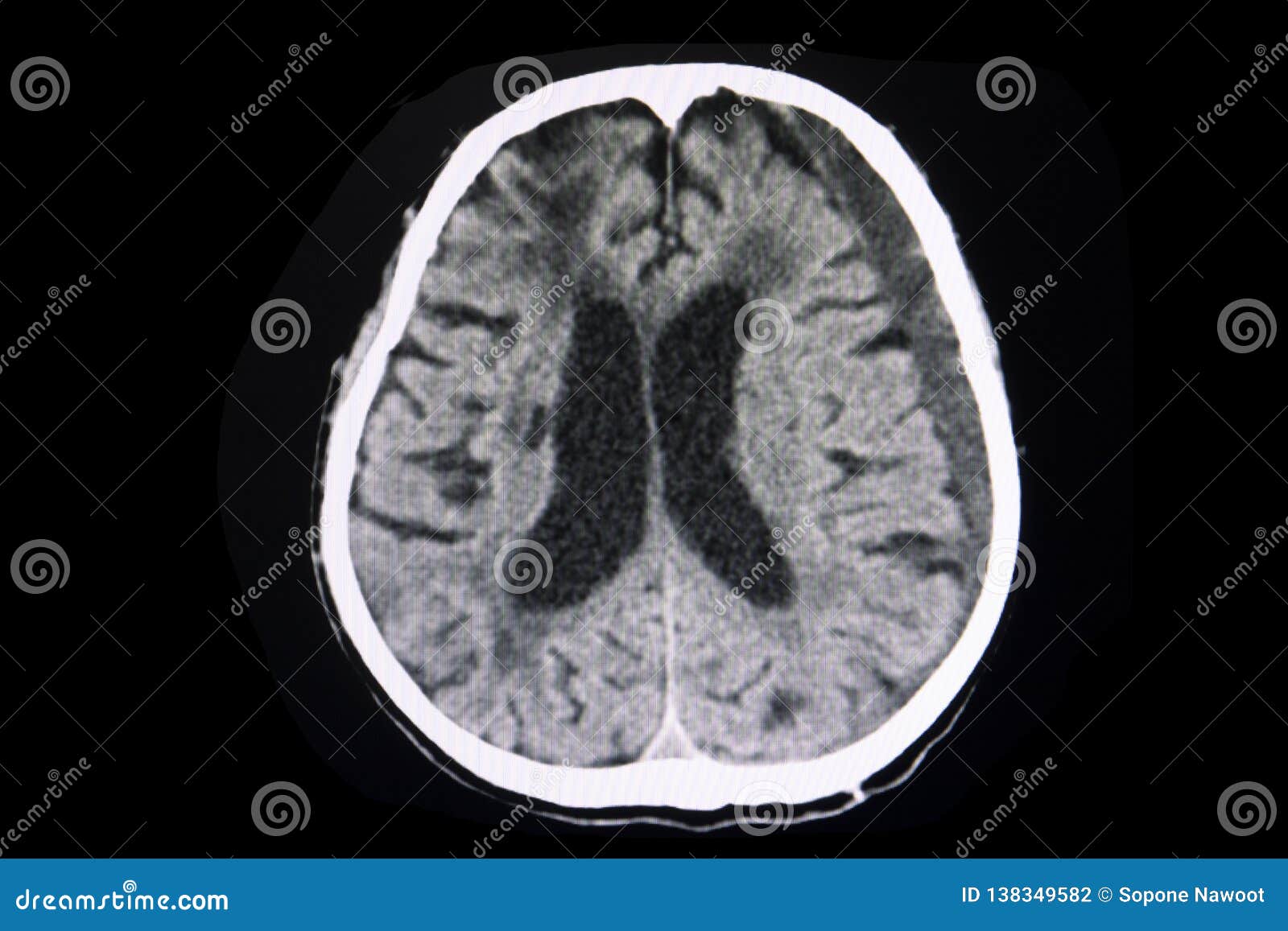 CT Hersenen Subacuut Subdural Hematoom Stock Foto - Image of hersen ...
