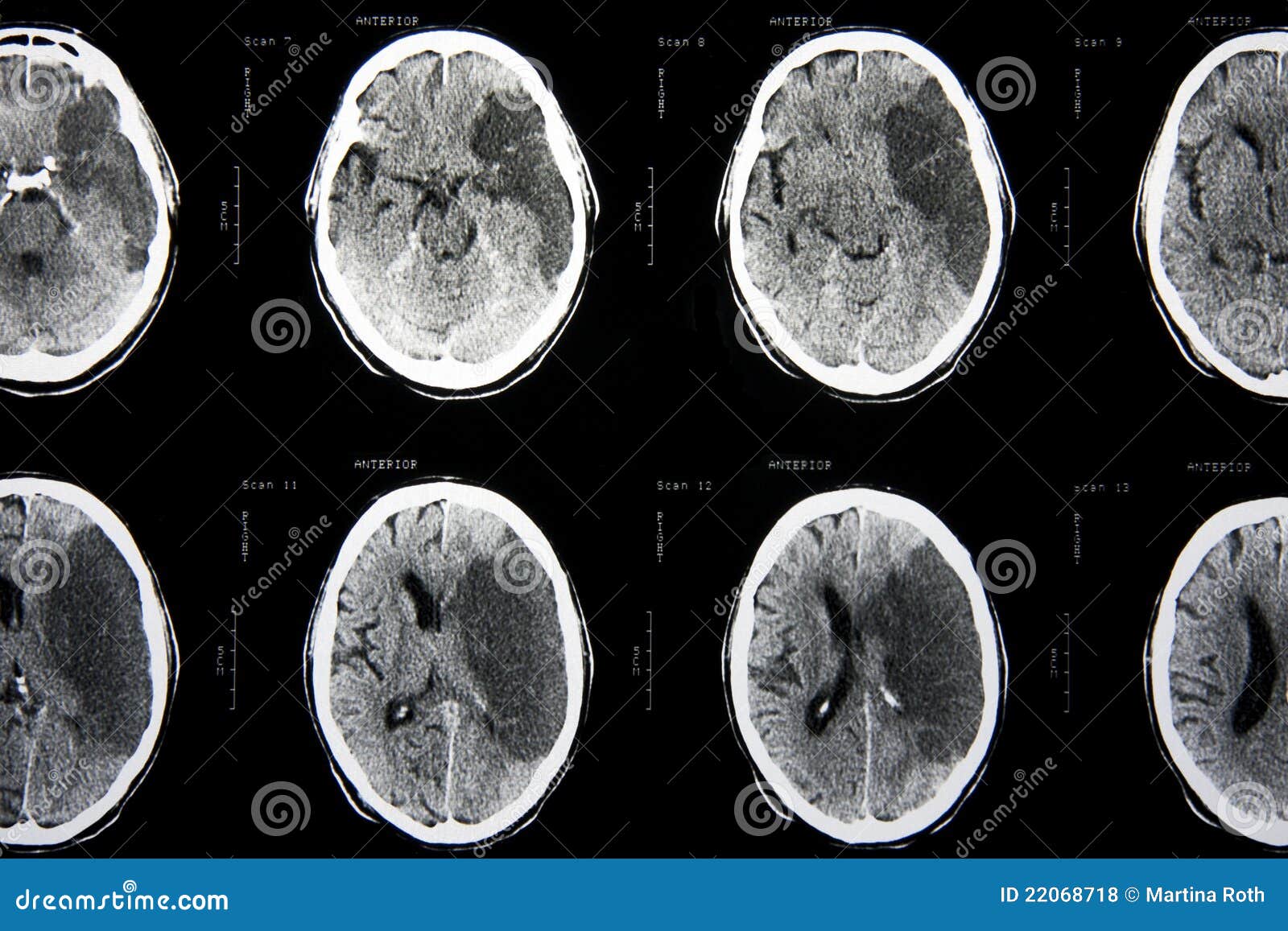 CT of an insulted brain stock photo. Image of apoplex - 22068718