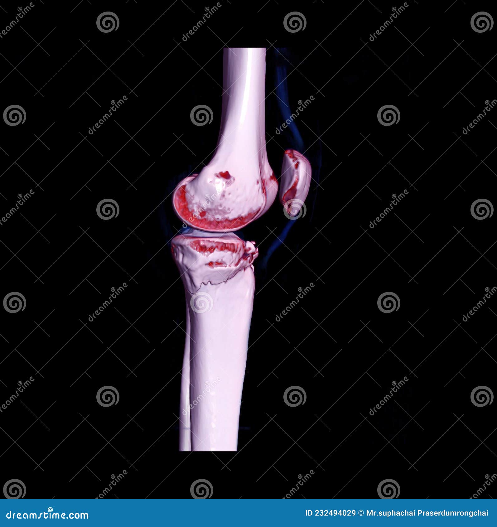 Fracture Of The Tibia. Two Types Of Fracture. Vector Royalty-Free ... Fracture Of The Tibia. Two Types Of Fracture. Vector Royalty-Free ...