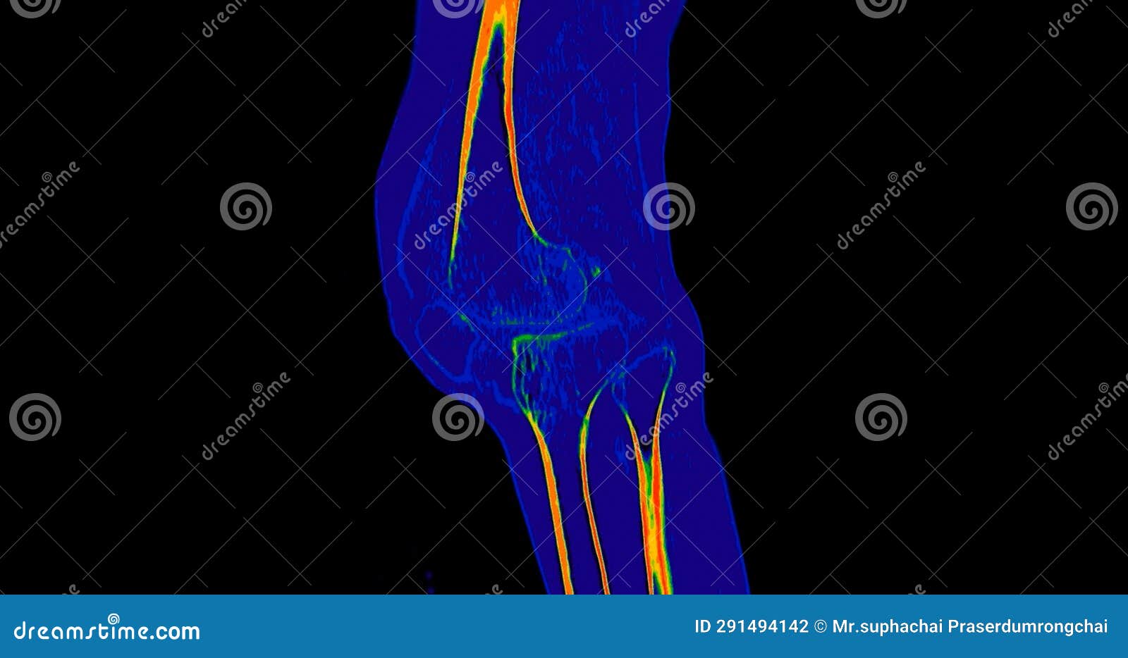 CT Knee or CT Scan Image of Knee Joint Sagittal View Stock Illustration ...