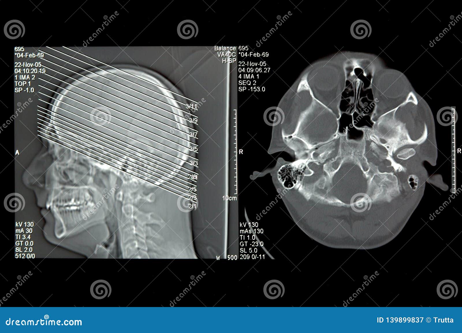 Ct-Kopfbild stockbild. Bild von gehirn, abbildung, magnetisch - 139899837