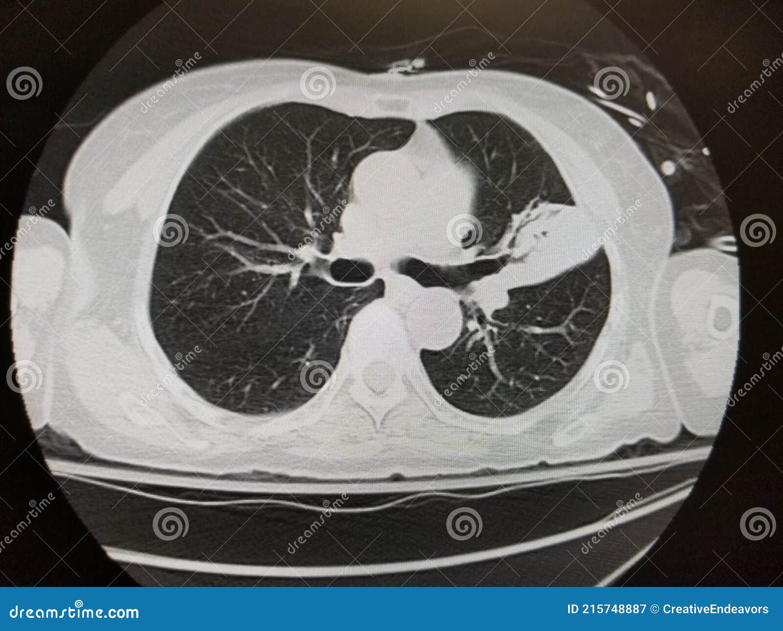 Left Upper Lobe Pneumonia with Cryptococcus Neoformans - CT Scan Stock ...
