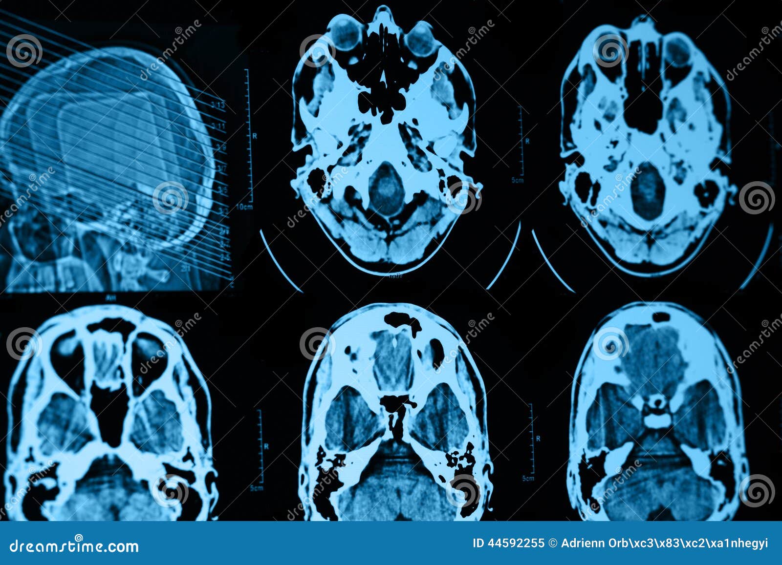 CT and MRI of the skull stock image. Image of anatomy - 44592255