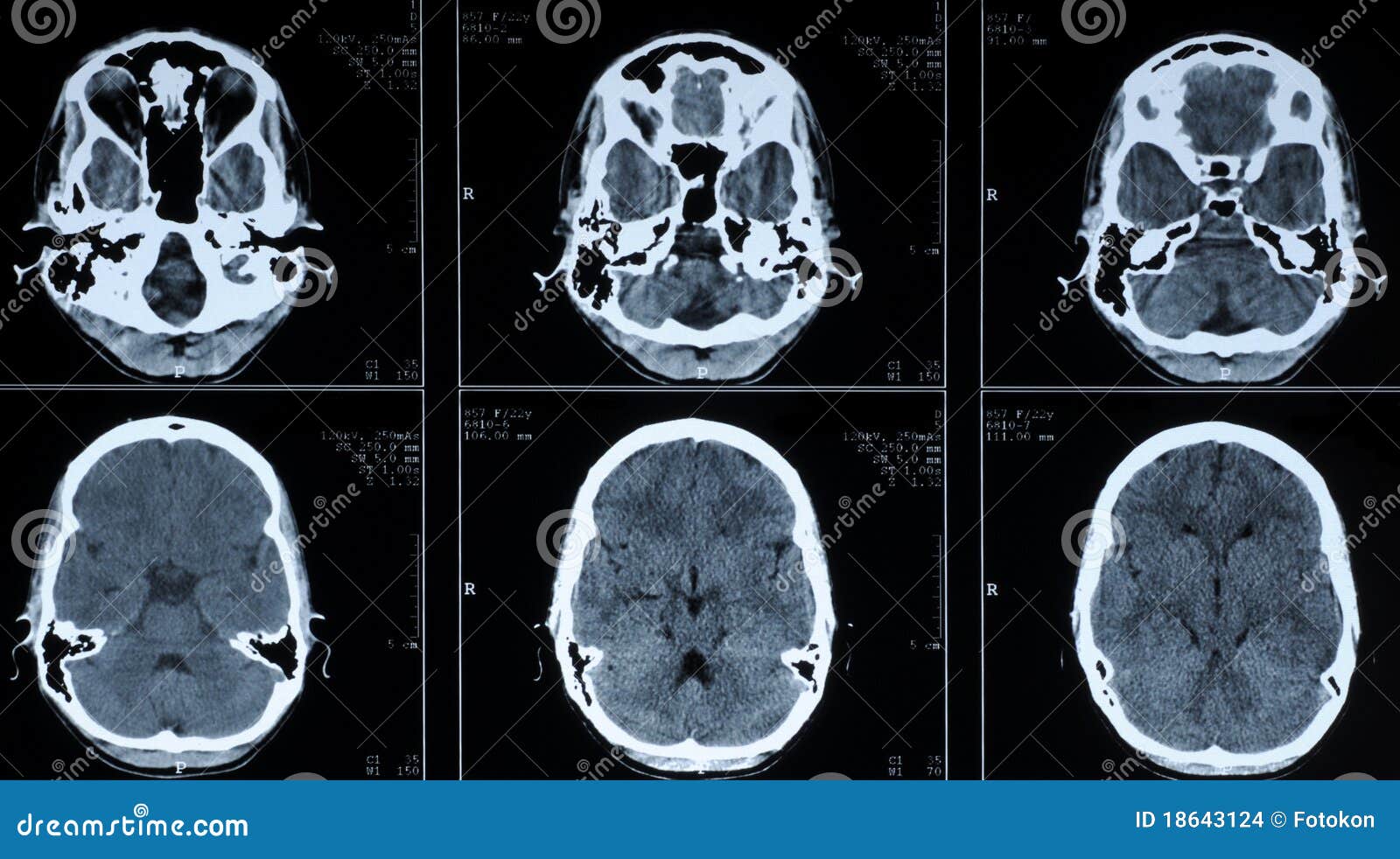 CT Photography of Human Brain Stock Photo - Image of cerebrum, xray ...