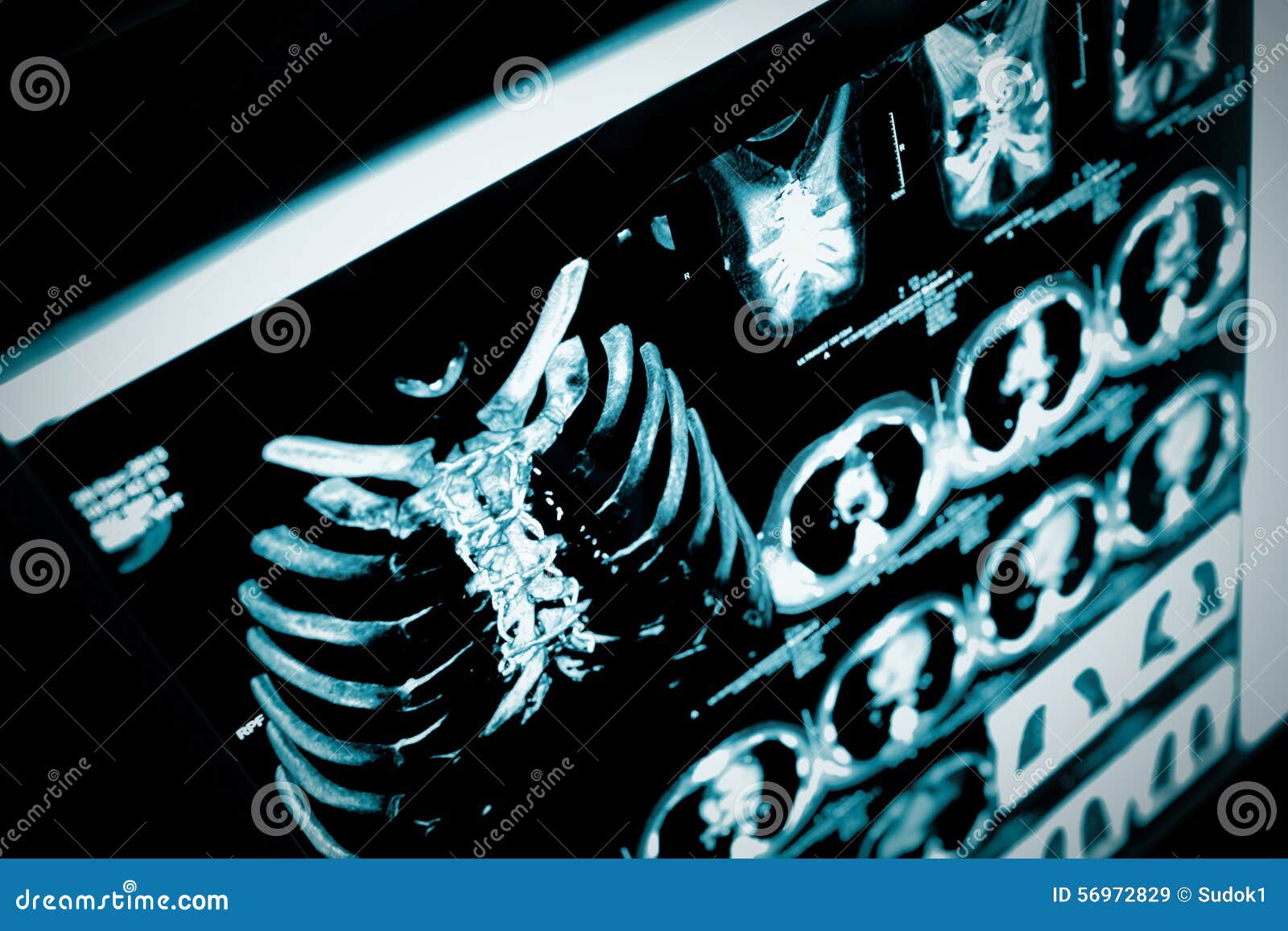 CT Reconstruction in 3D of the Patient S Chest Stock Image - Image of ...