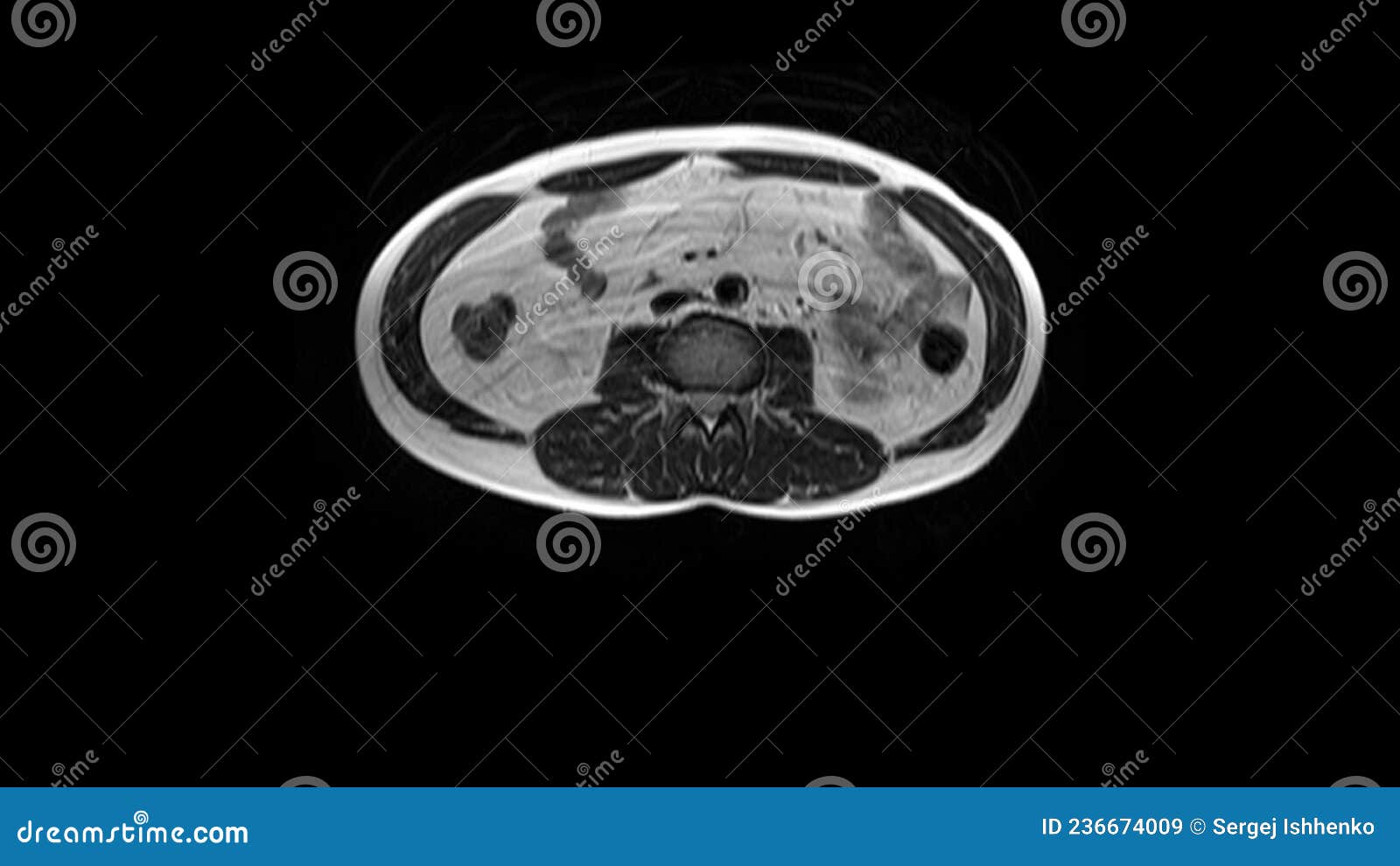 CT Scan of the Abdomen. Computed Tomography of the Gastrointestinal ...