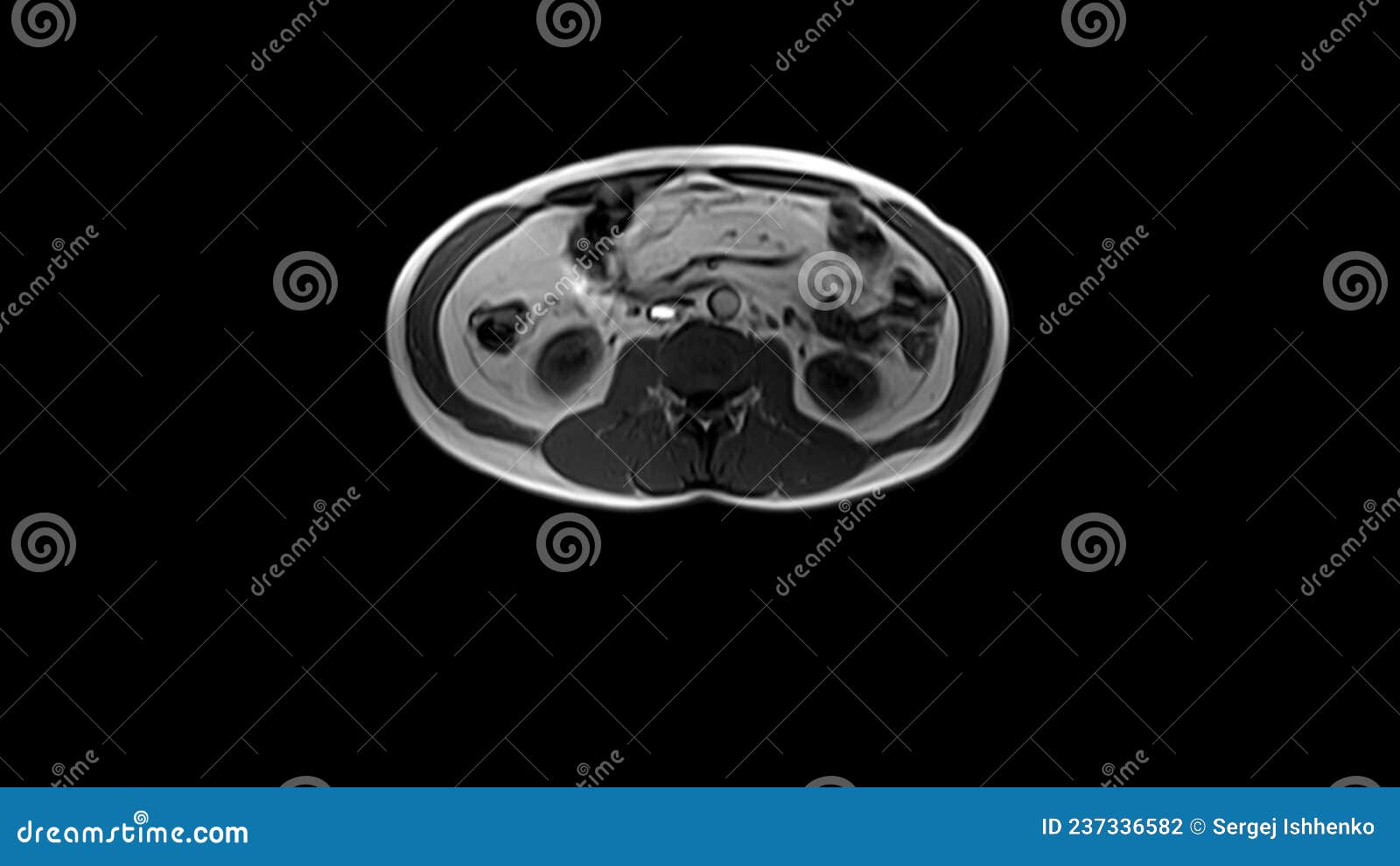 CT Scan of the Abdomen. Computed Tomography of the Gastrointestinal ...