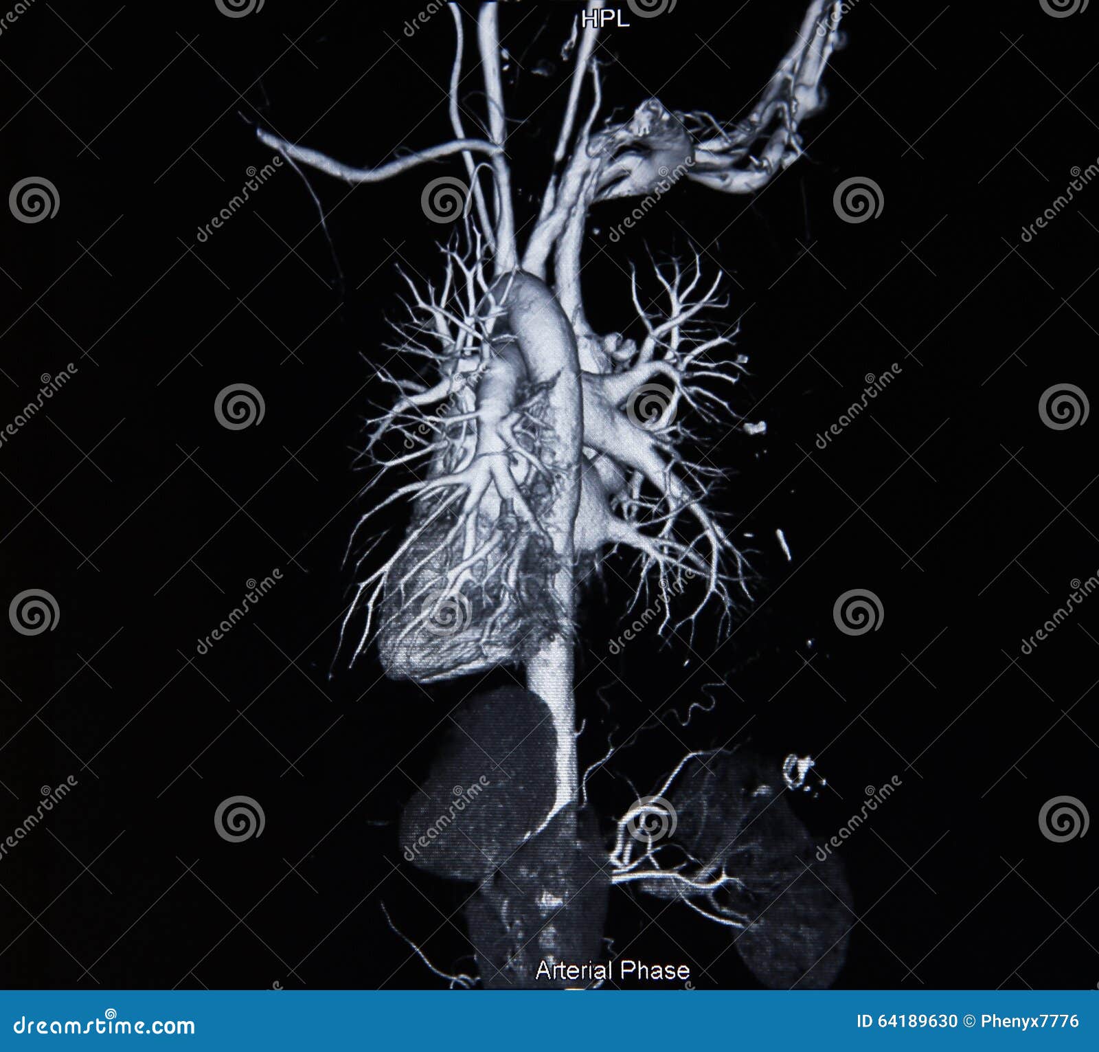 Ct Scan Angiogram (take Photo from Film X-ray) Stock Photo - Image of ...