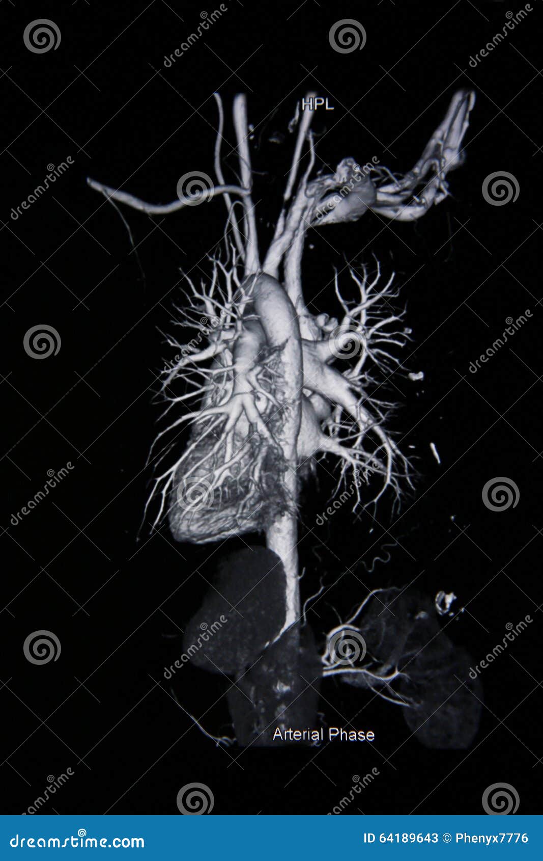 Ct Scan Angiogram (take Photo from Film X-ray) Stock Image - Image of ...