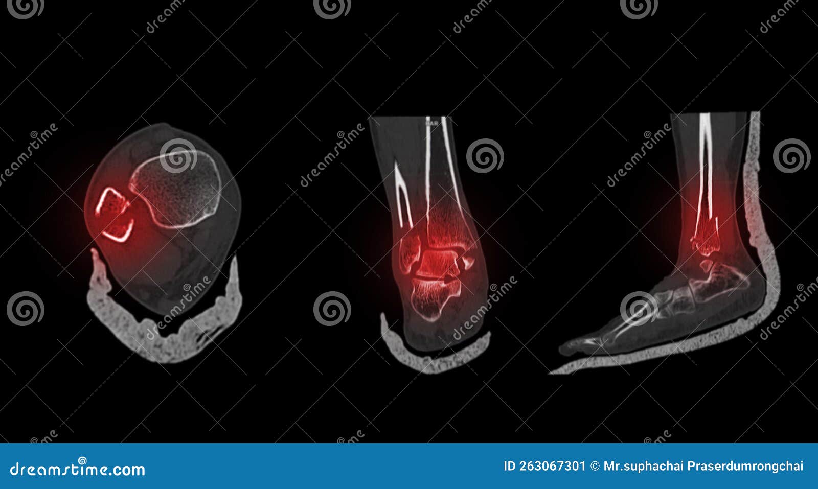 Ct Scan Ankle And Foot Or Computed Tomography Of Ankle Joint And Foot 3d Volume Rendering Image