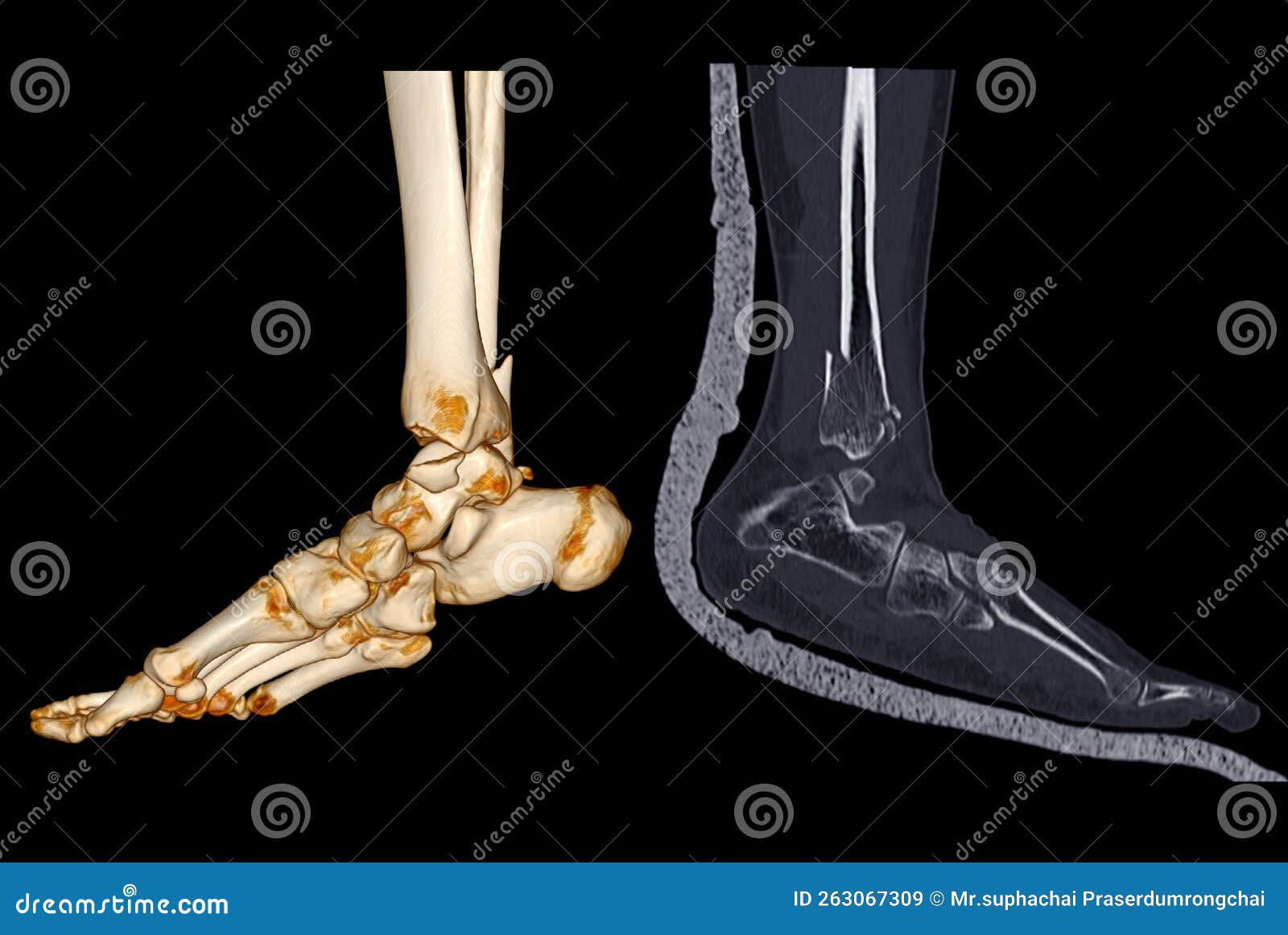 Ct Scan Ankle And Foot Or Computed Tomography Of Ankle Joint And Foot 3d Volume Rendering Image