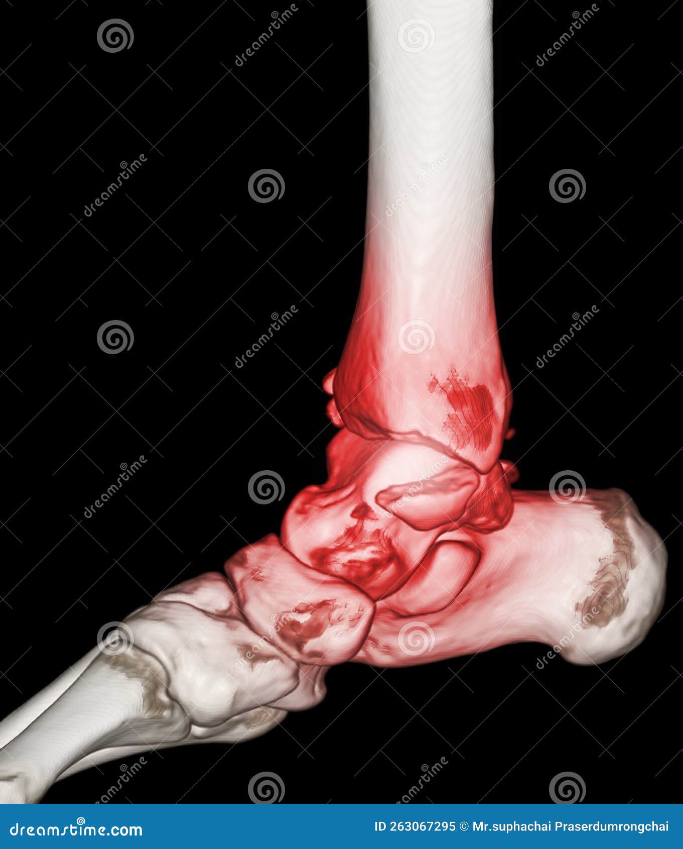 Ct Scan Ankle And Foot Or Computed Tomography Of Ankle Joint And Foot 3d Volume Rendering Image