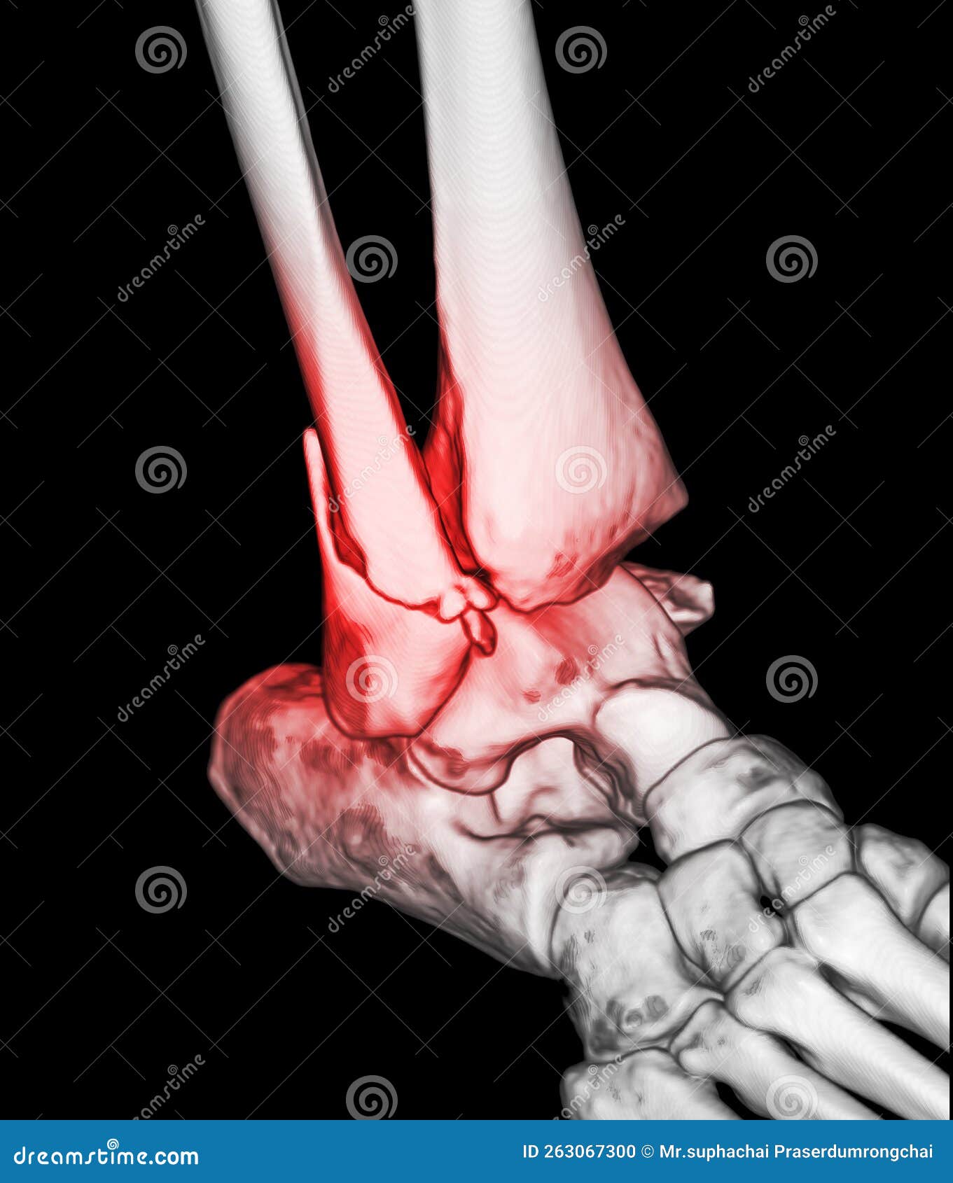 Ct Scan Ankle And Foot Or Computed Tomography Of Ankle Joint And Foot 3d Volume Rendering Image