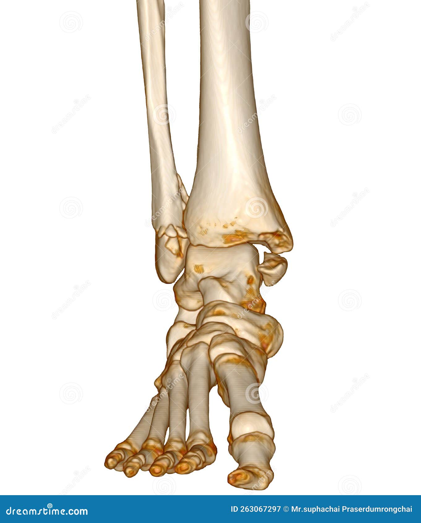Ct Scan Ankle And Foot Or Computed Tomography Of Ankle Joint And Foot 3d Volume Rendering Image