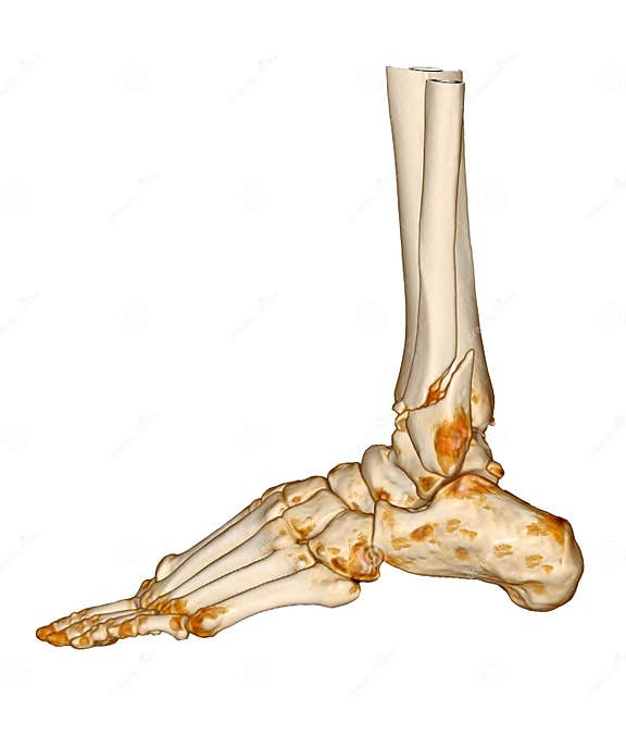 Ct Scan Ankle And Foot Or Computed Tomography Of Ankle Joint And Foot 3d Volume Rendering Image