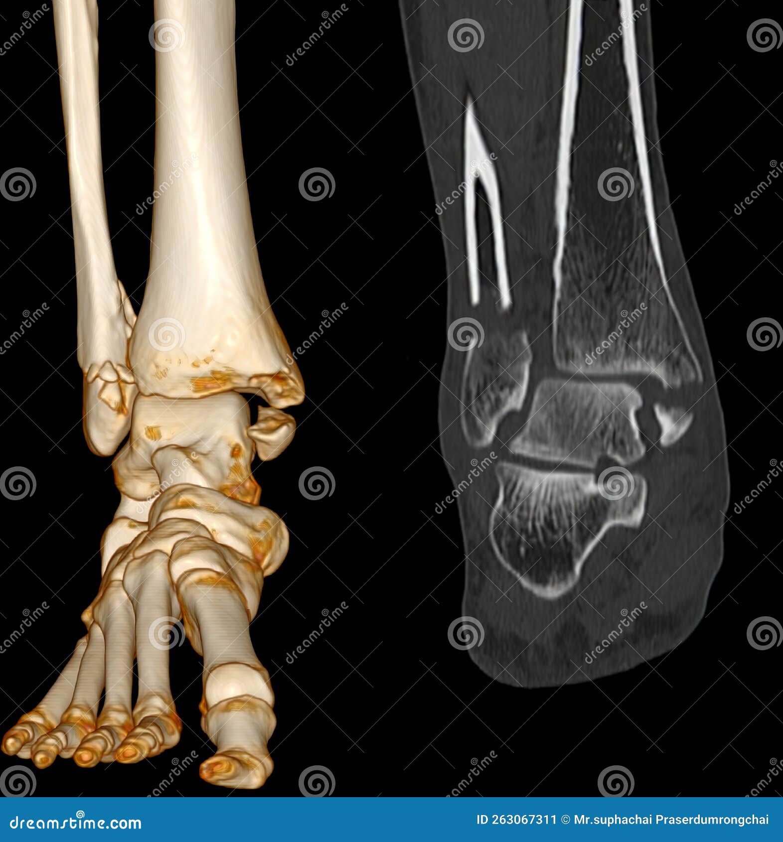 CT Scan Ankle and Foot or Computed Tomography of Ankle Joint and Foot ... CT Scan Ankle and Foot or Computed Tomography of Ankle Joint and Foot ...