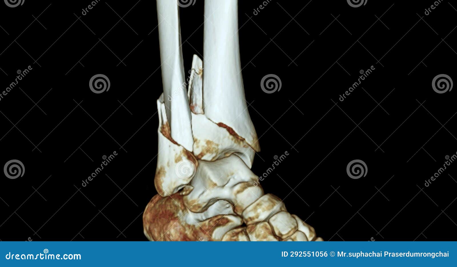 CT Scan Ankle Joint 3D Rendering Image Showing Fracture Tibia and ...