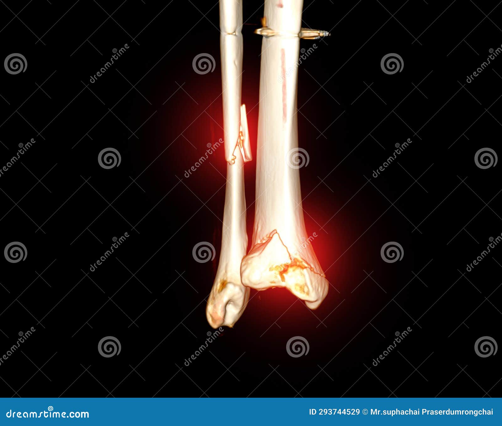 CT Scan Ankle Joint 3D Rendering Image Showing Fracture Tibia and ...