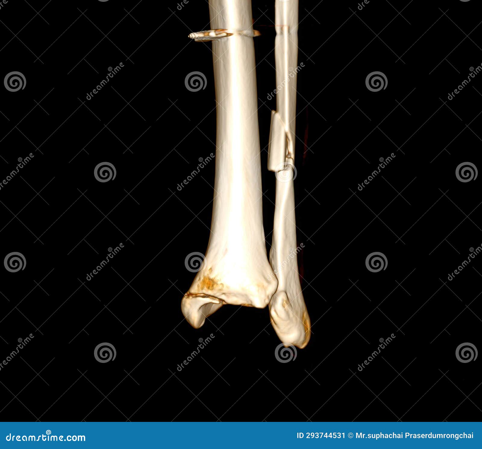 CT Scan Ankle Joint 3D Rendering Image Showing Fracture Tibia and ...