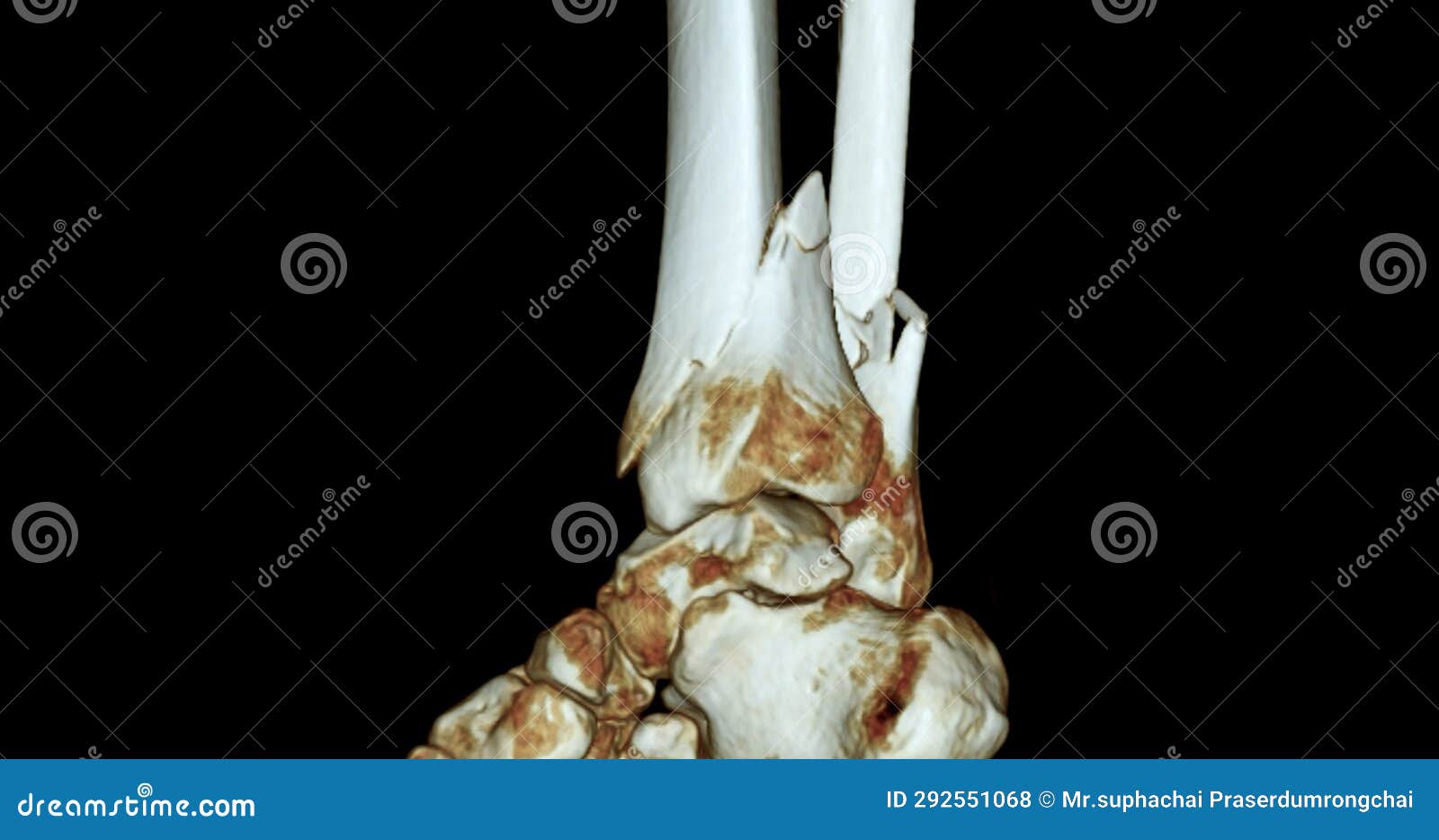 CT Scan Ankle Joint 3D Rendering Image Showing Fracture Tibia and ...